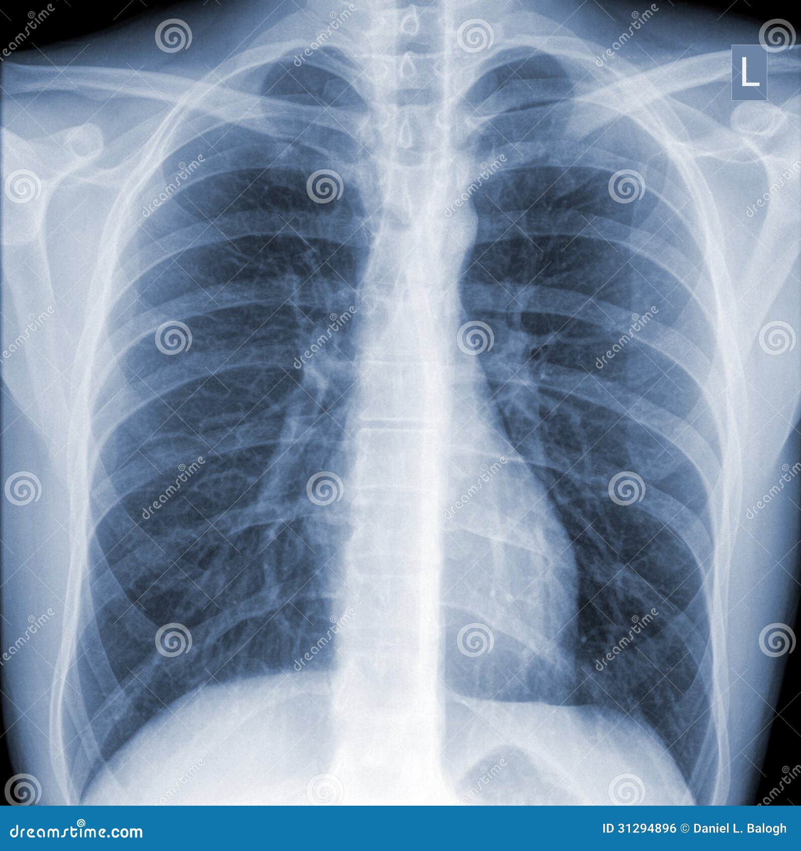 Radiografía del pecho foto de archivo. Imagen de costillas - 31294896