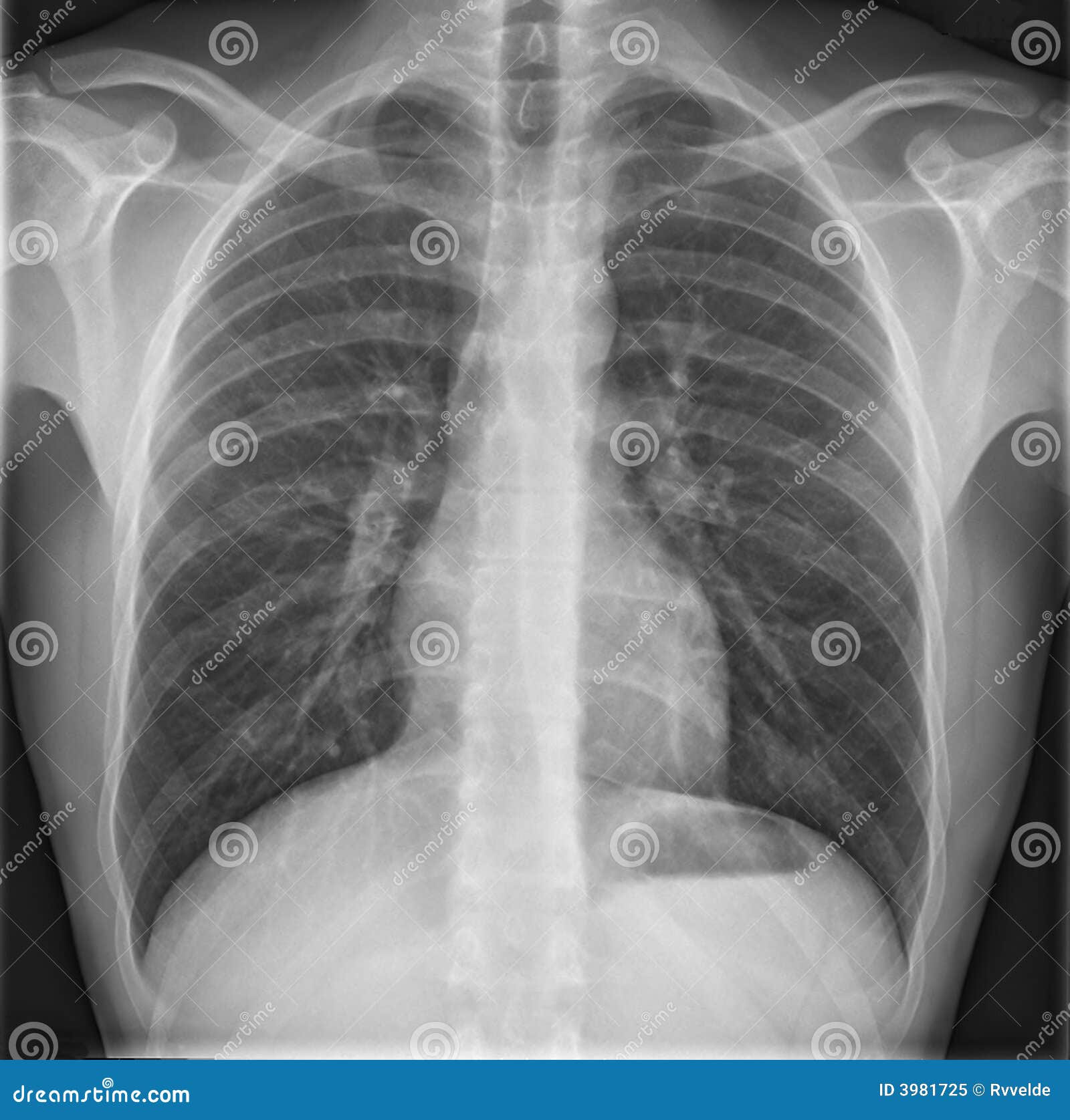 Radiografía del pecho imagen de archivo. Imagen de huesos - 3981725