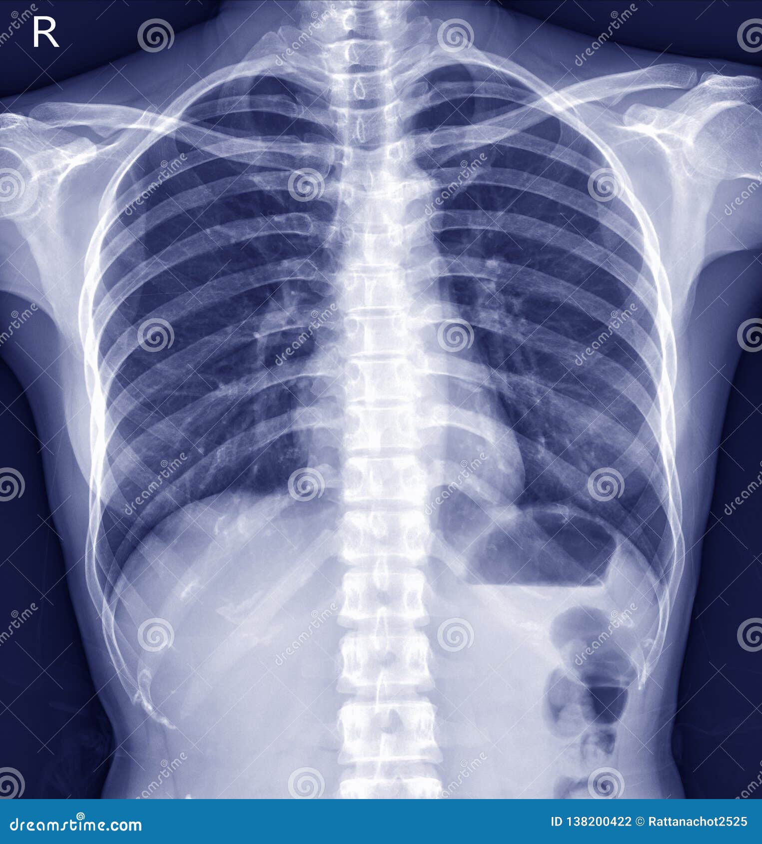 Radiografía Del Pecho Normal, Concepto Médico Foto de archivo - Imagen ...