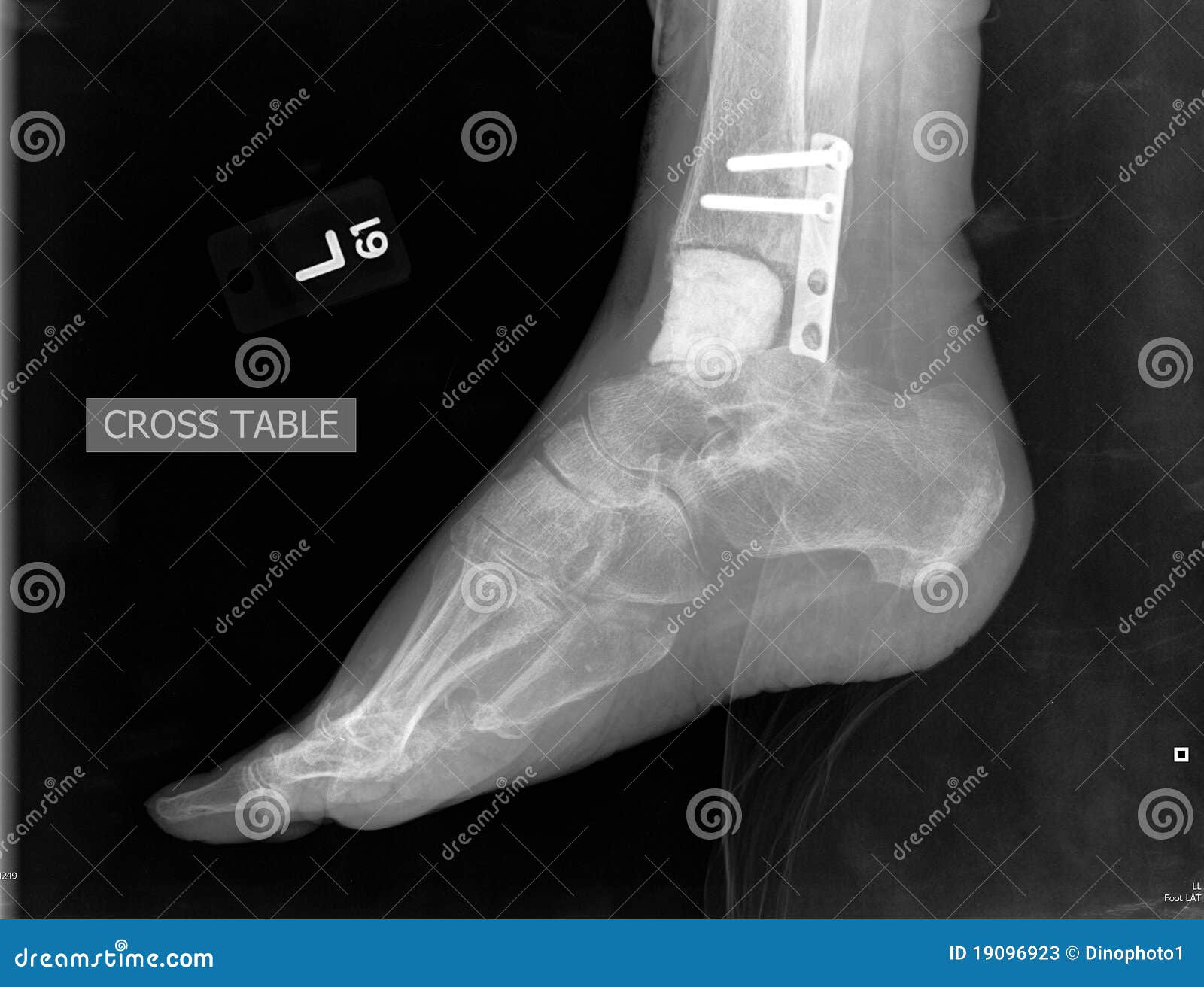 Radiografía del pie imagen de archivo. Imagen de tornillos - 19096923