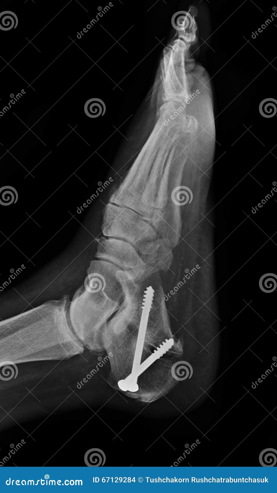 RADIOGRAFÍA DEL PIE foto de archivo. Imagen de salud - 67129284