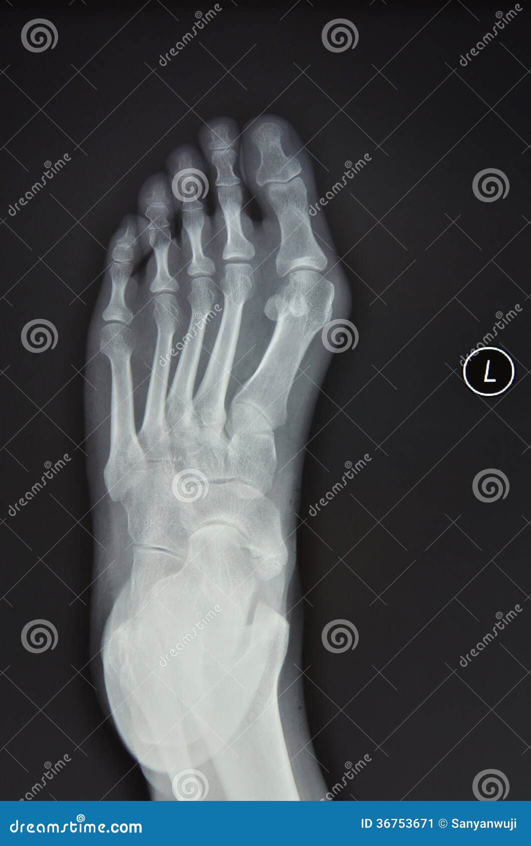 Radiografía Del Pie Izquierdo Imagen de archivo - Imagen de fotos ...