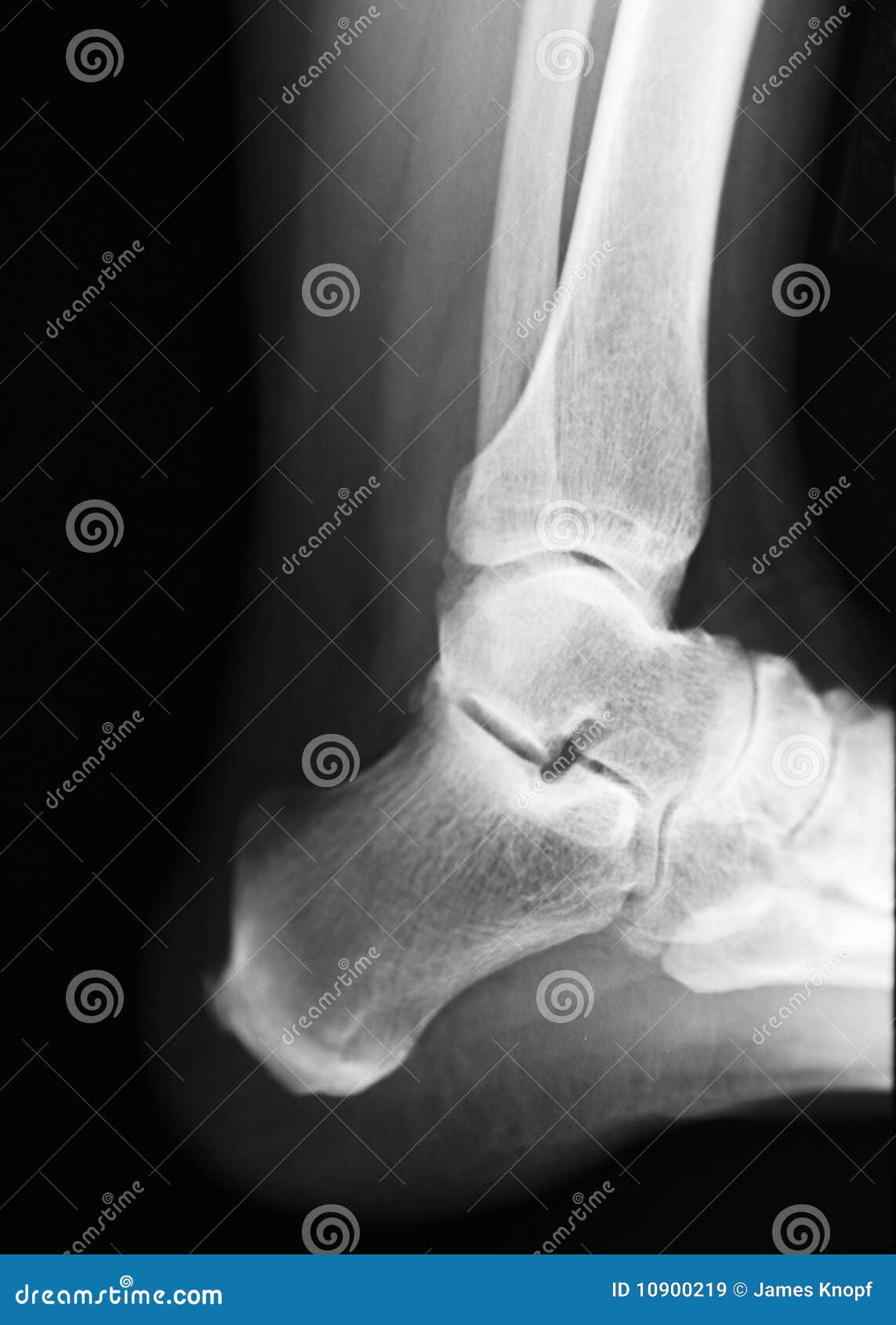 Radiografía del talón imagen de archivo. Imagen de enfermedad - 10900219