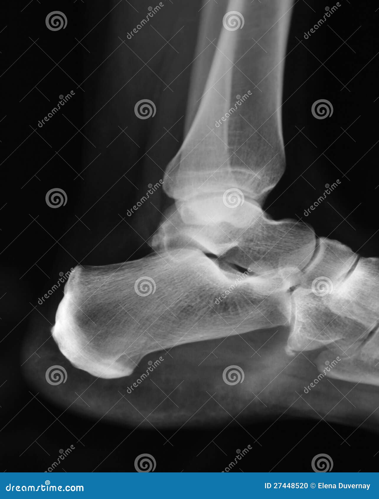 Radiografía del tobillo foto de archivo. Imagen de enfermedad - 27448520