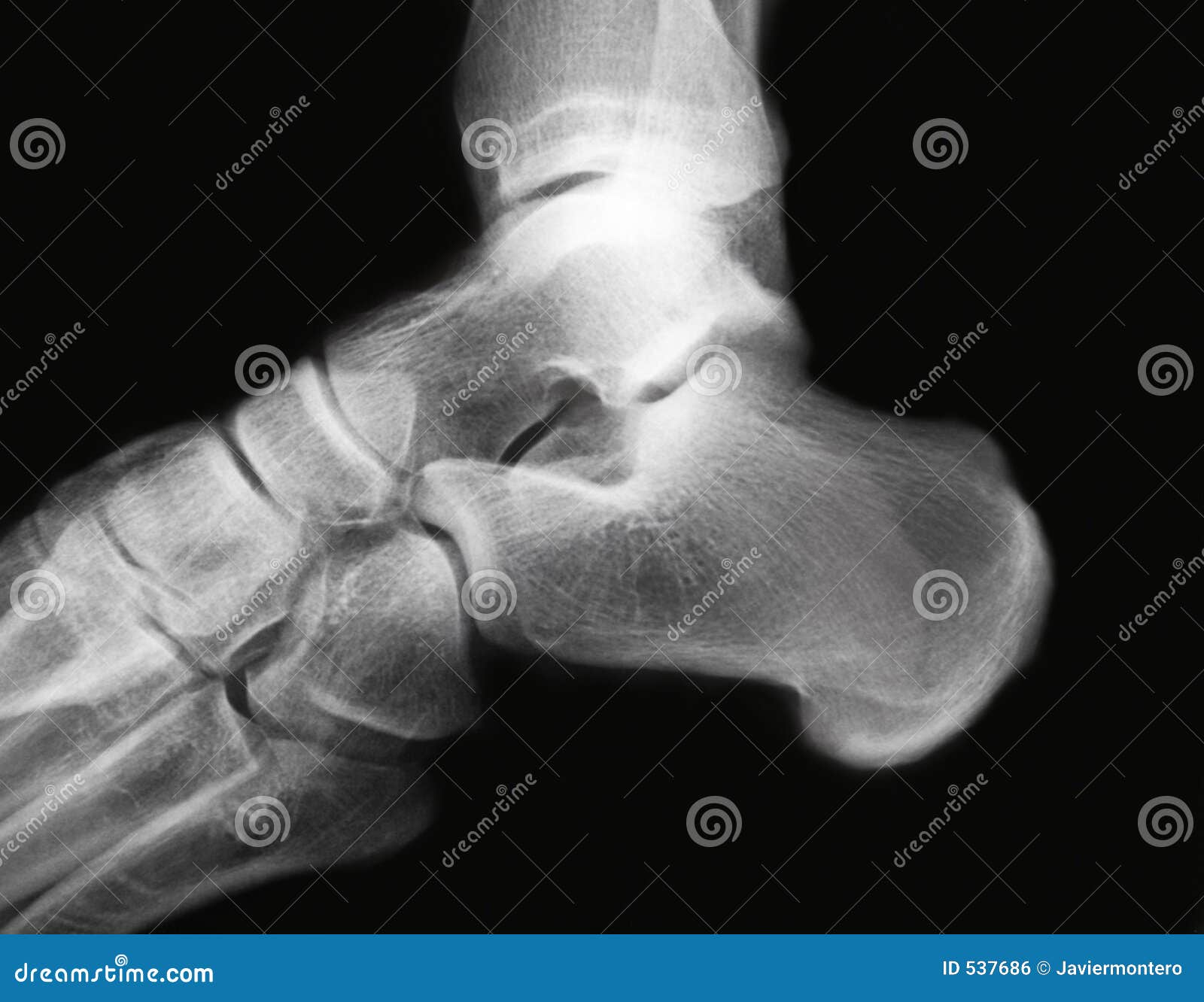Radiografía De Tobillo Roto