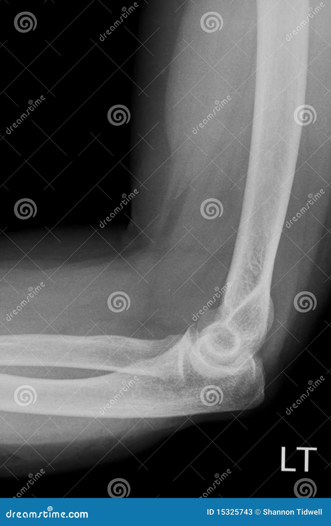 Radiografía Lateral Del Codo Imagen de archivo - Imagen de blanco ...