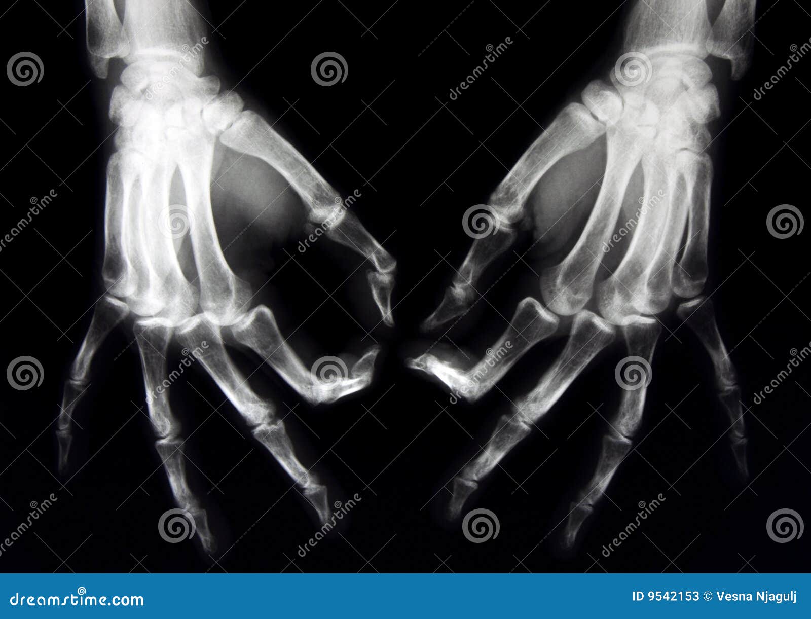 Radiografía Normal De Ambas Manos Imagen de archivo - Imagen de ...