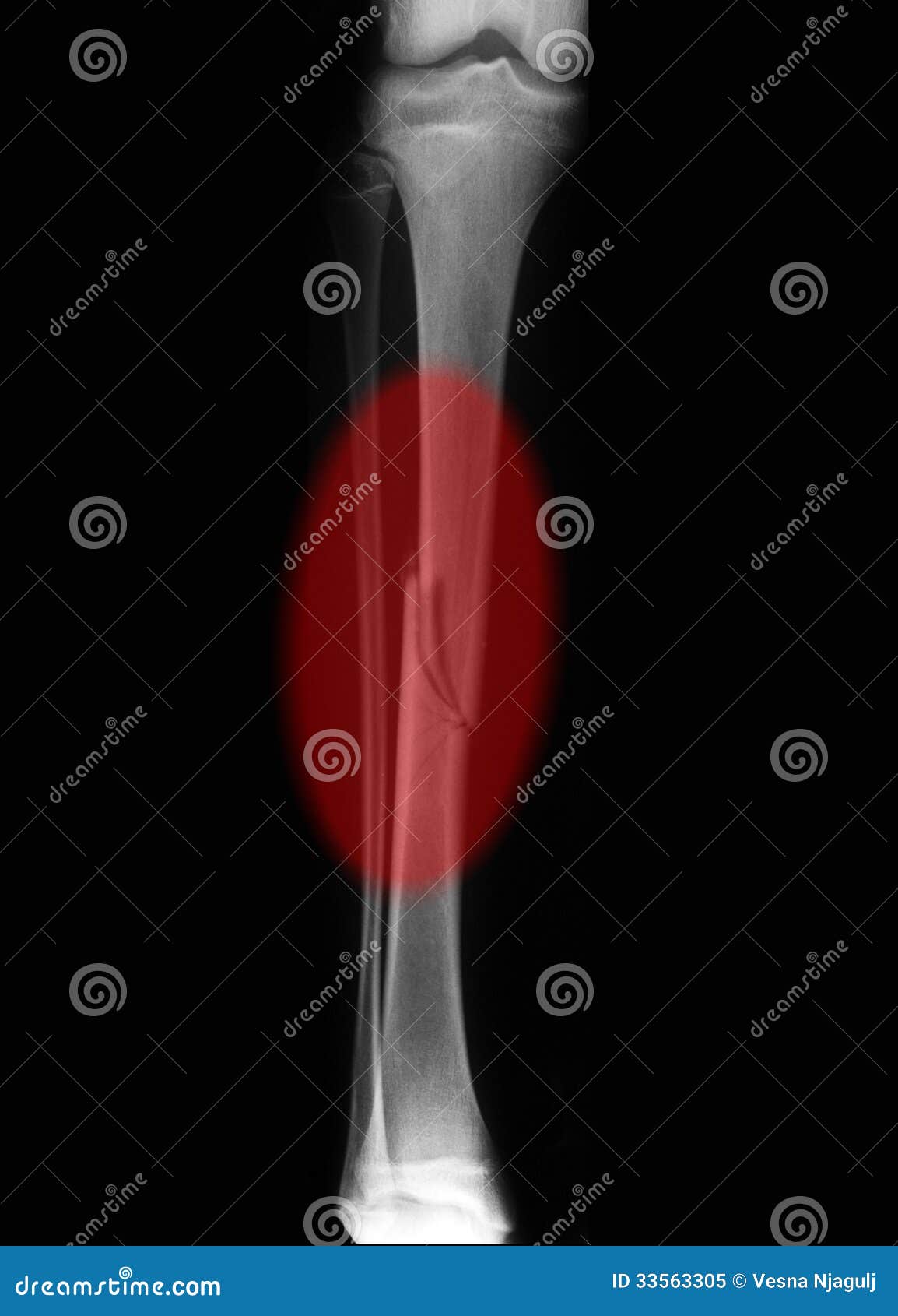 Radiografía Quebrada De La Tibia Imagen de archivo - Imagen de rayo ...