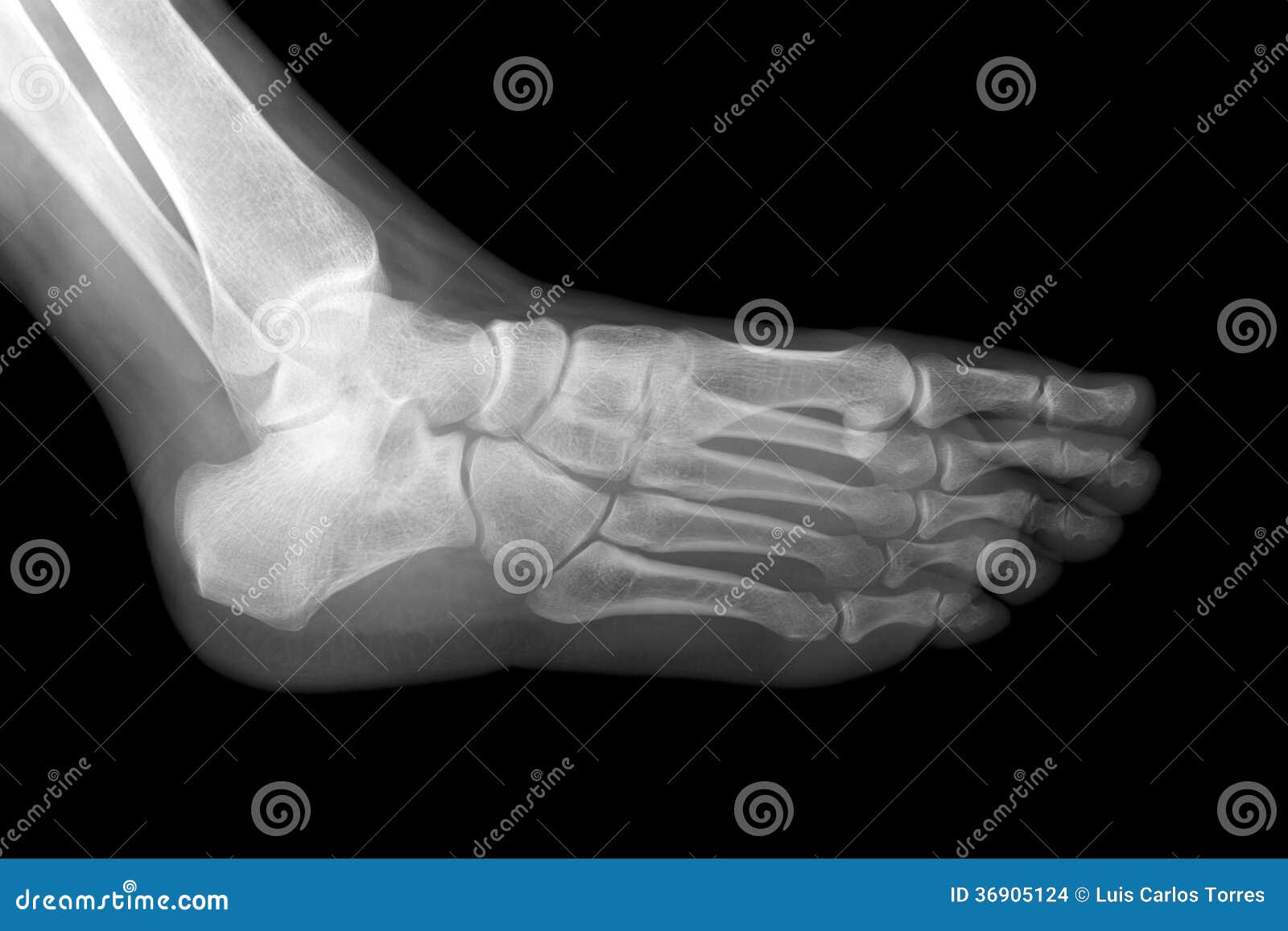 Radiografía Del Pie Izquierdo Imagenes de archivo - Imagen: 36905124