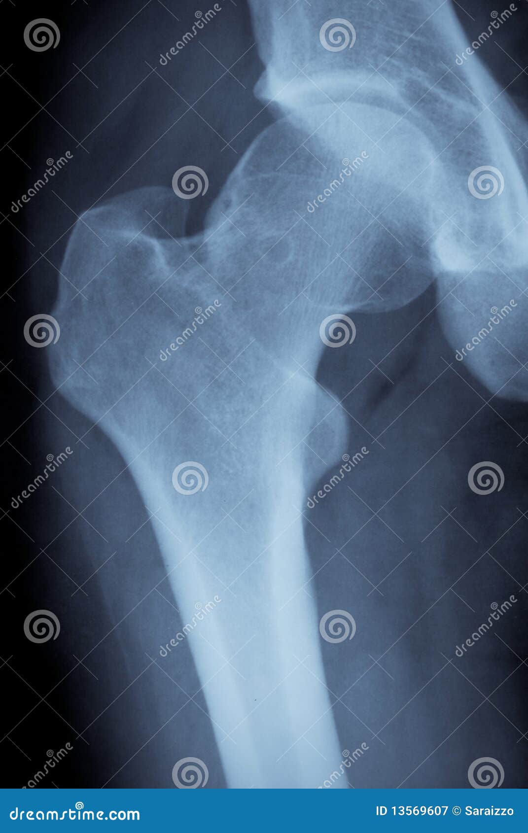 Radiografia immagine stock. Immagine di femore, radiografia - 13569607