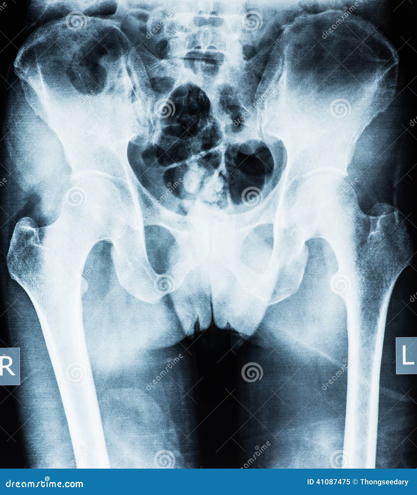 Radiografia del bacino immagine stock. Immagine di scheletro - 41087475