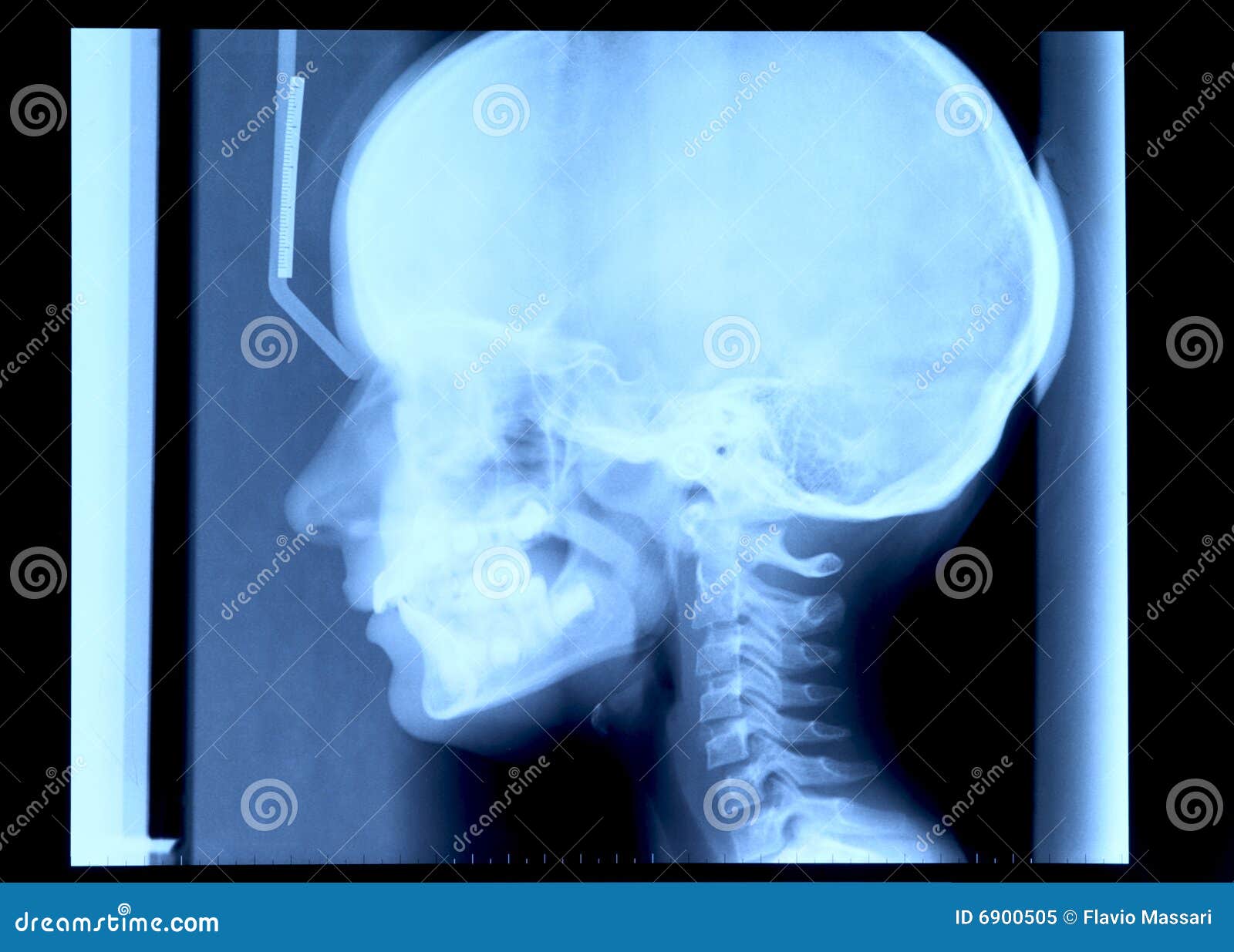 Radiografia Del Cranio Foto Stock - Download 574 Royalty Free Photos