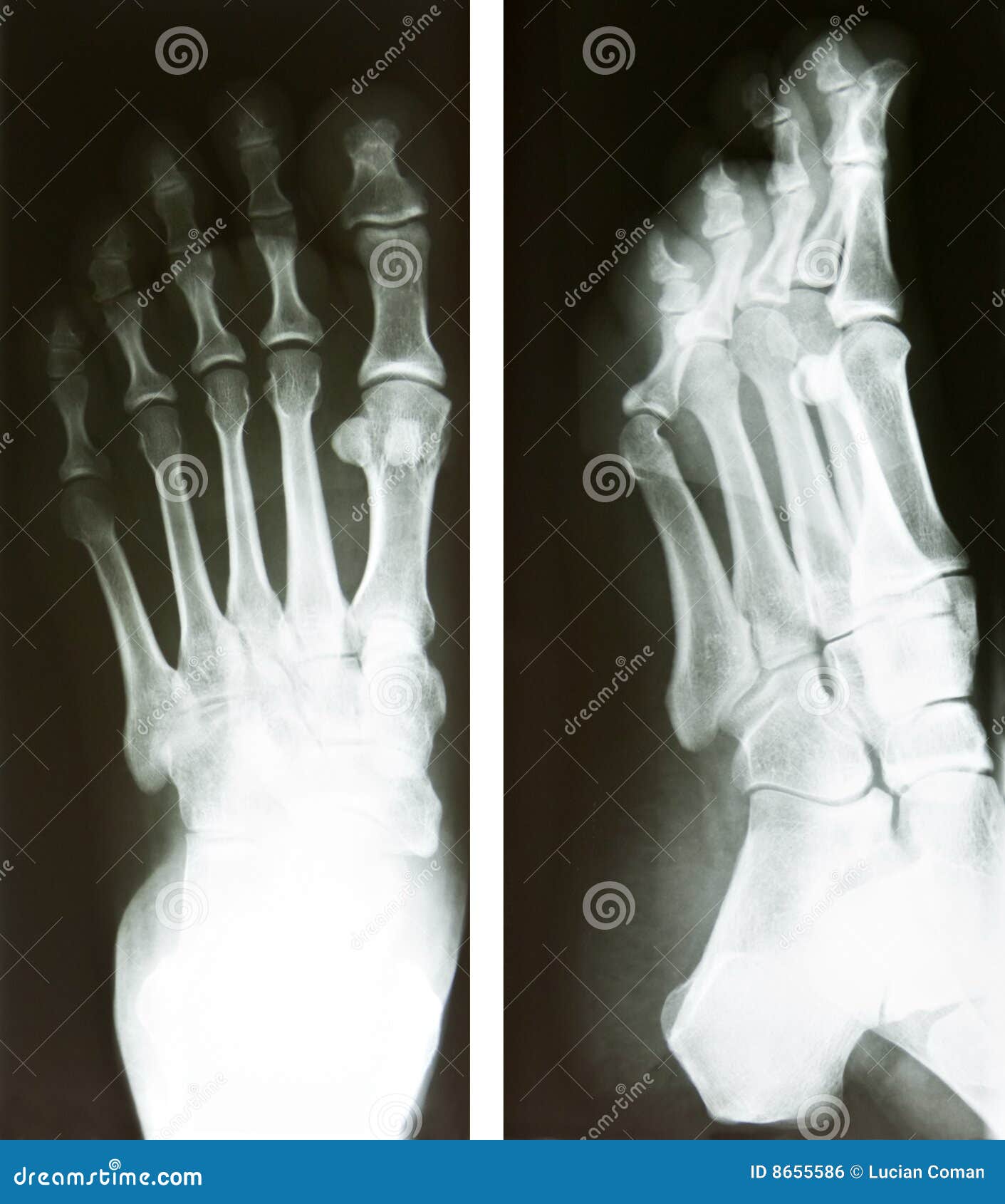 Radiografia del piede fotografia stock. Immagine di clinico - 8655586