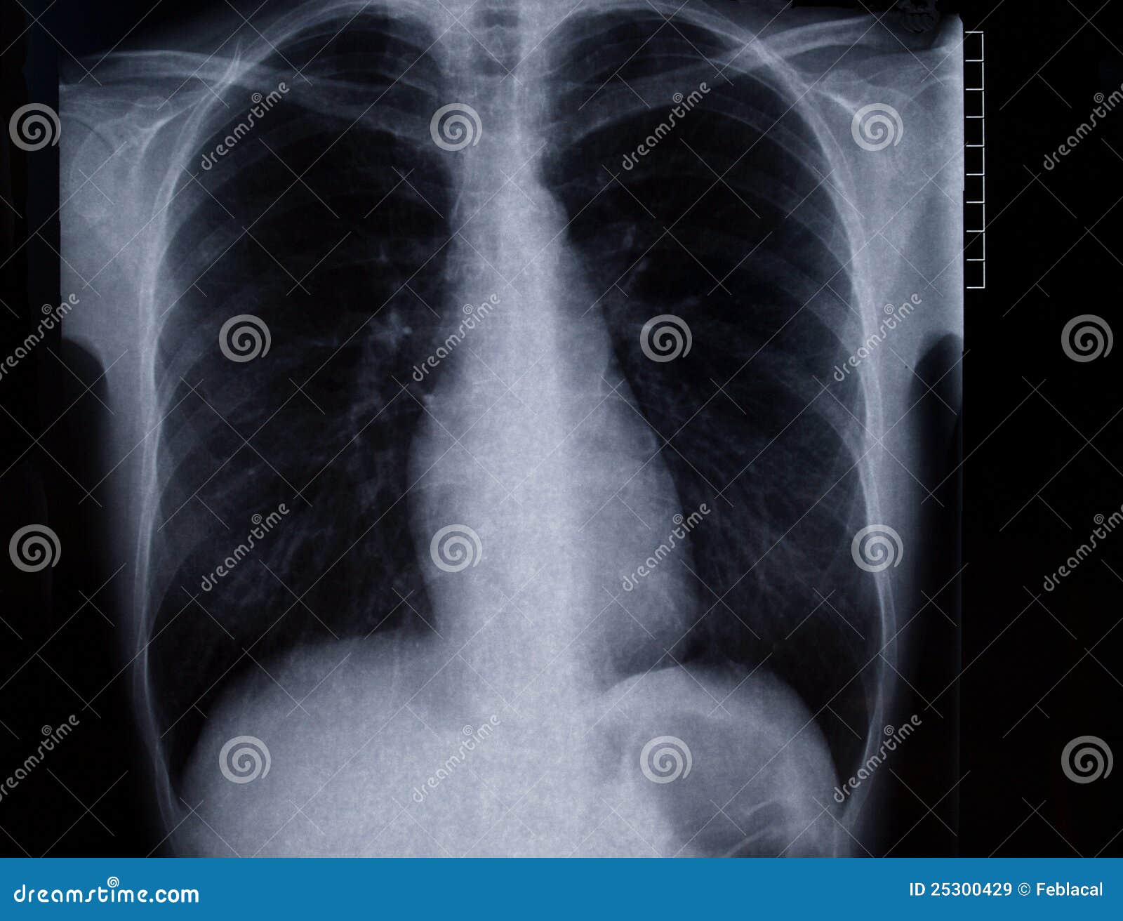 Radiografia del torace immagine stock. Immagine di indietro - 25300429