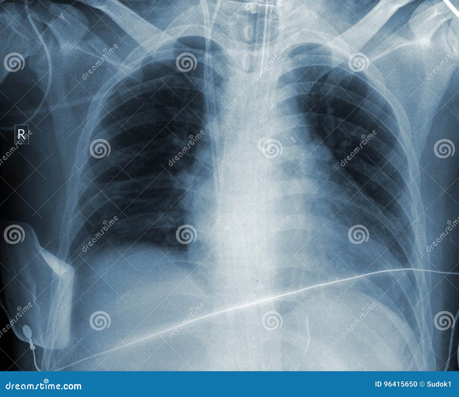 Radiogram Result of Patient Chest Stock Photo - Image of chest ...