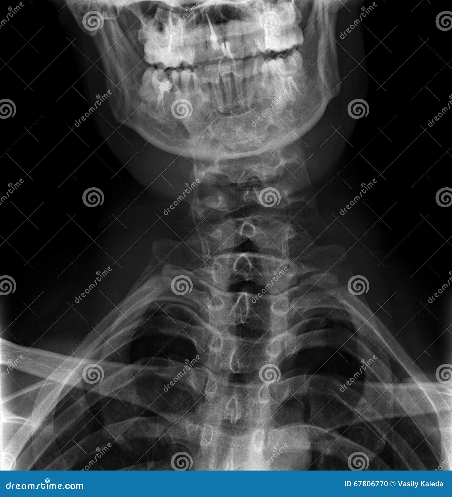 Radiogramma del collo fotografia stock. Immagine di caduta - 67806770
