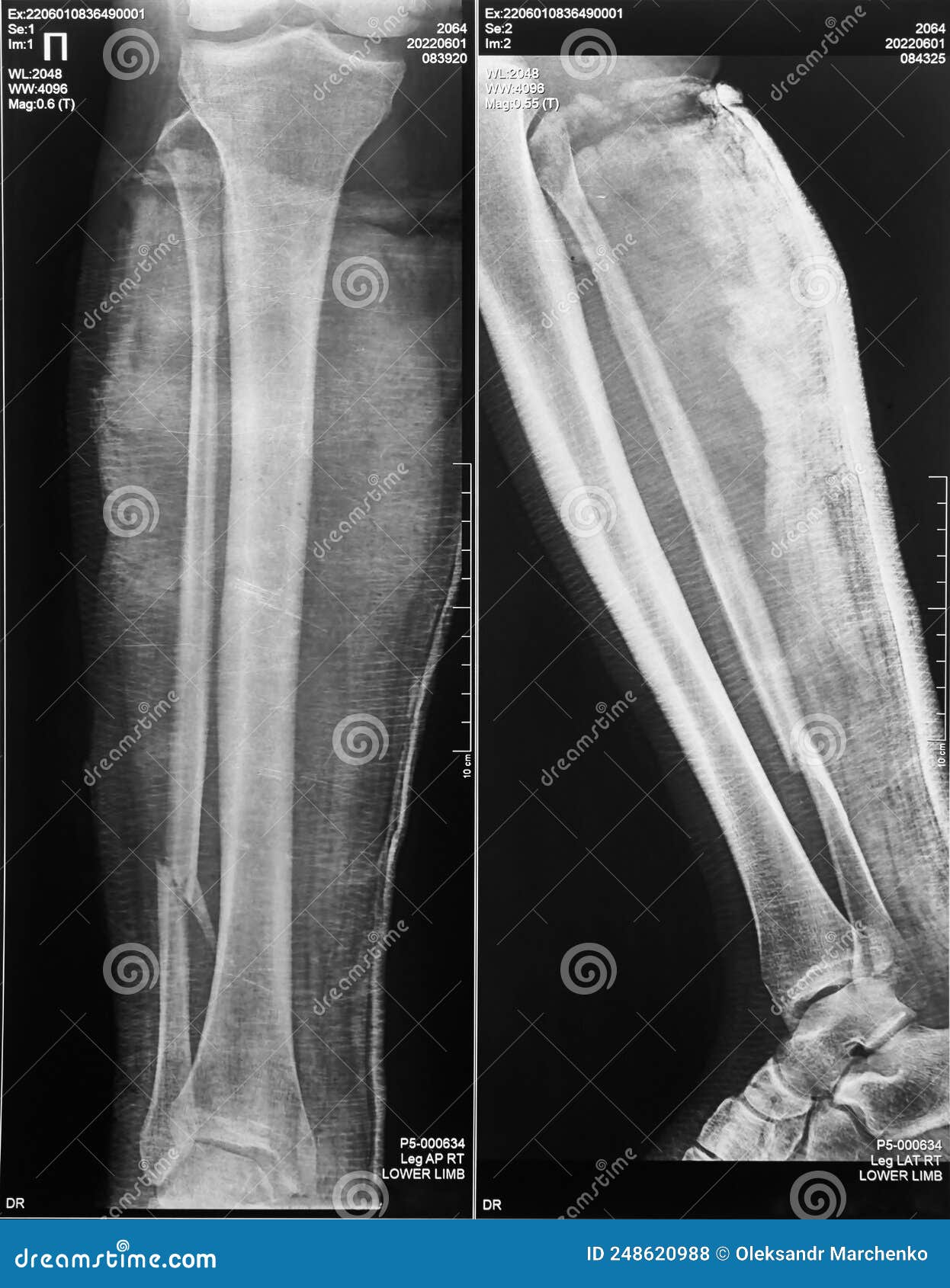 Comminuted Fracture Shaft Of Ulnar Bone Royalty-Free Stock Photo ...