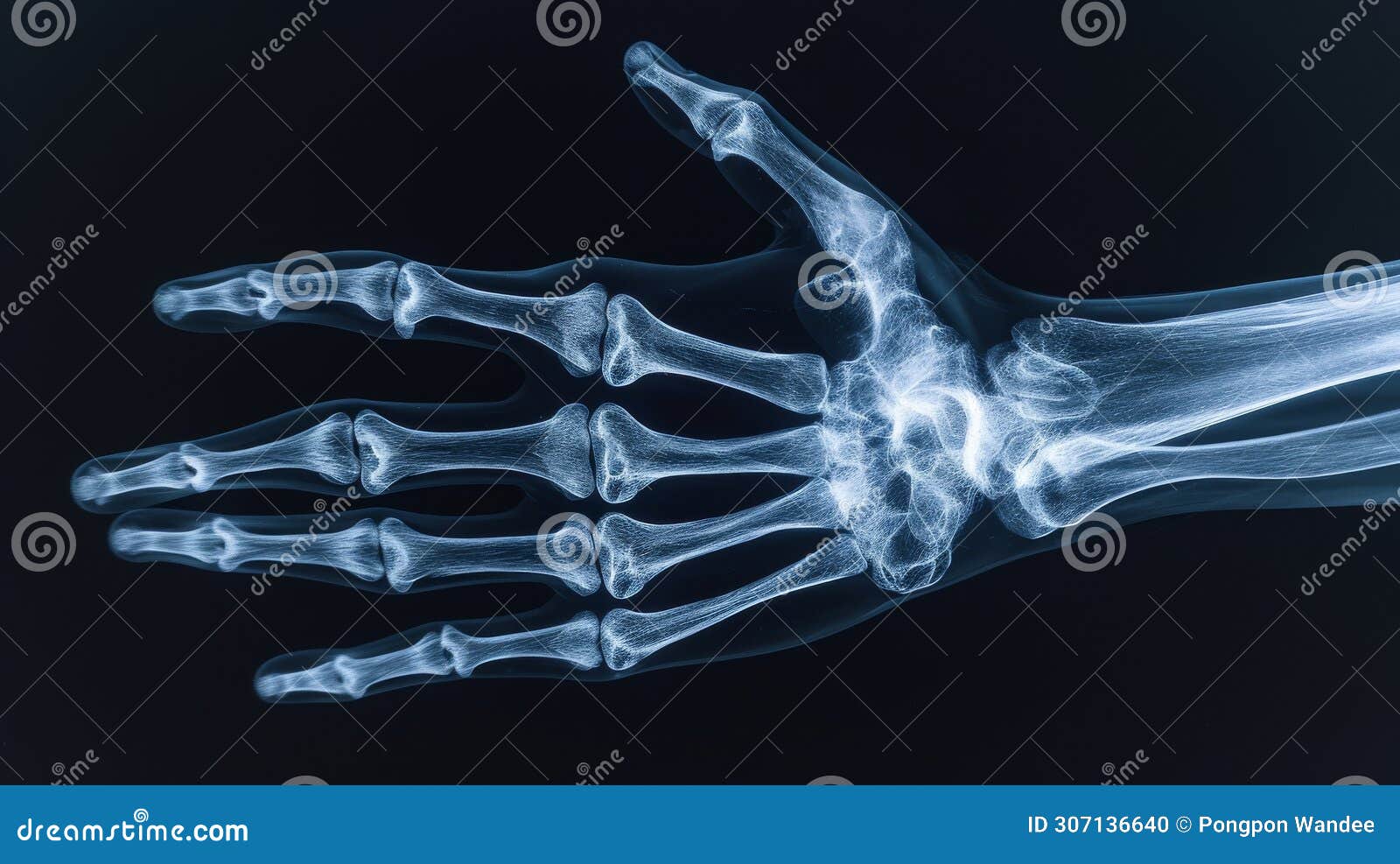 Radiograph of the Hand with Bone and Joint Abnormalities Stock ...
