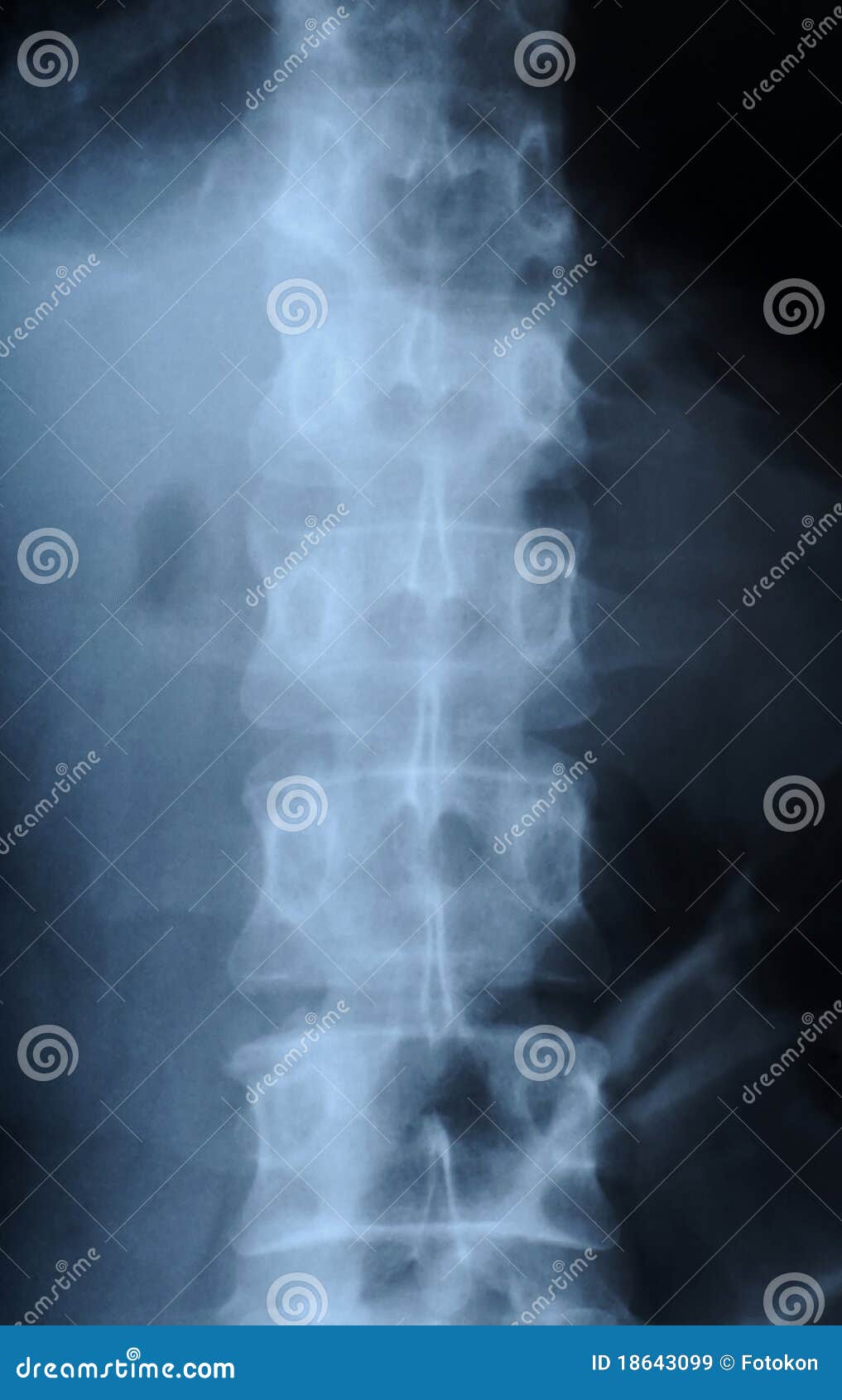 Radiograph of Human Backbone Stock Image - Image of diagnosis, medical ...