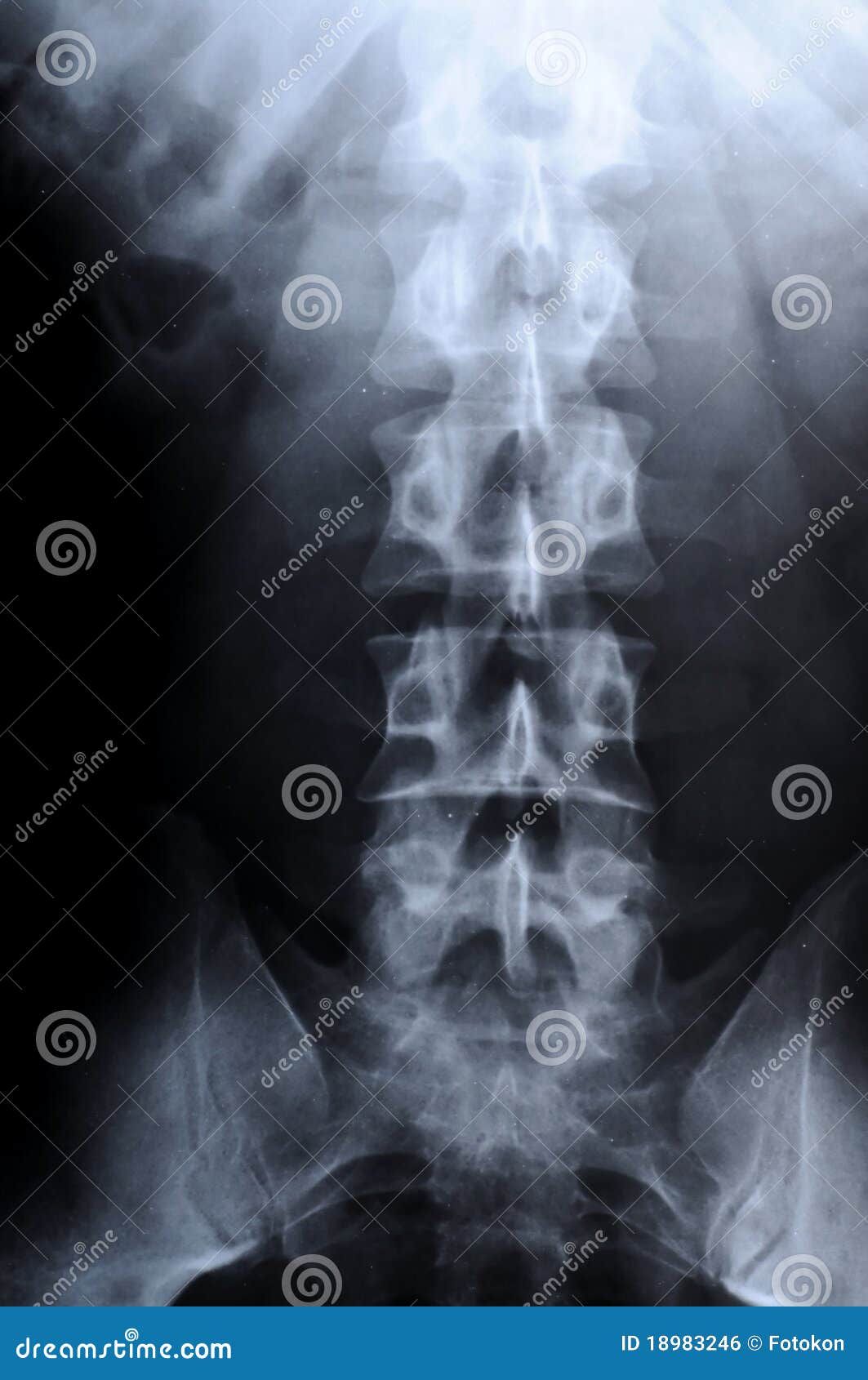 Radiograph of Human Backbone Stock Photo - Image of true, skeleton ...