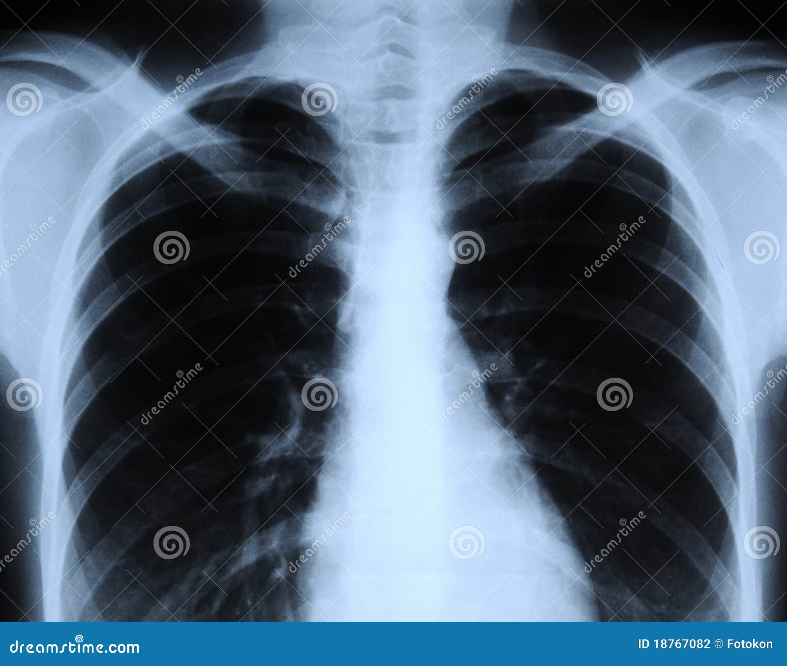 X-ray Of A Human Chest Or Lungs Radiography Shot. Royalty-Free Stock ...