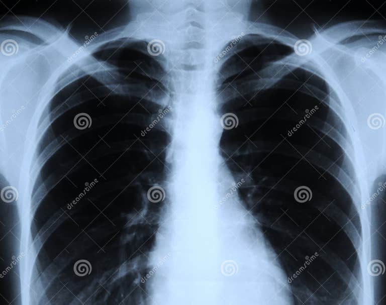 Radiograph of human chest stock photo. Image of backbone - 18767082
