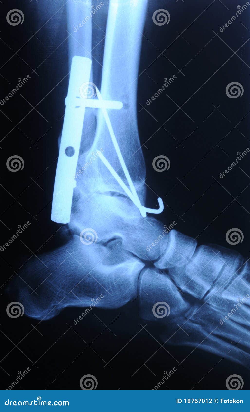 Fracture Of The Ankle Bones In A Teenage Girl Patient With A Cast And ...