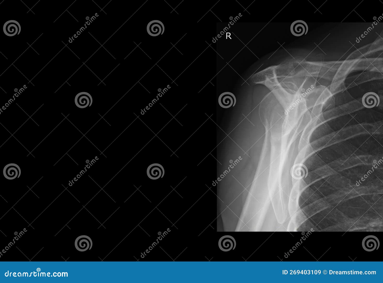 Radiograph of a Human Shoulder Stock Image - Image of health, medicine ...