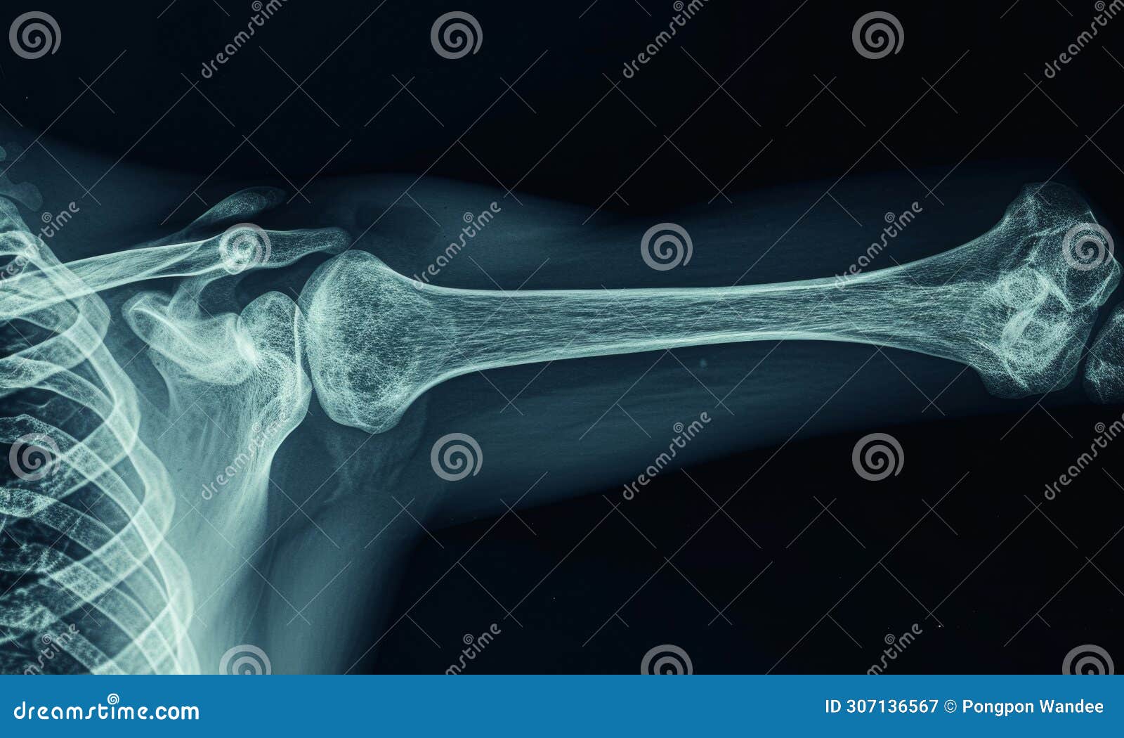 Radiograph Of The Shoulder Anatomy With Clavicle, Scapula, And Humerus ...