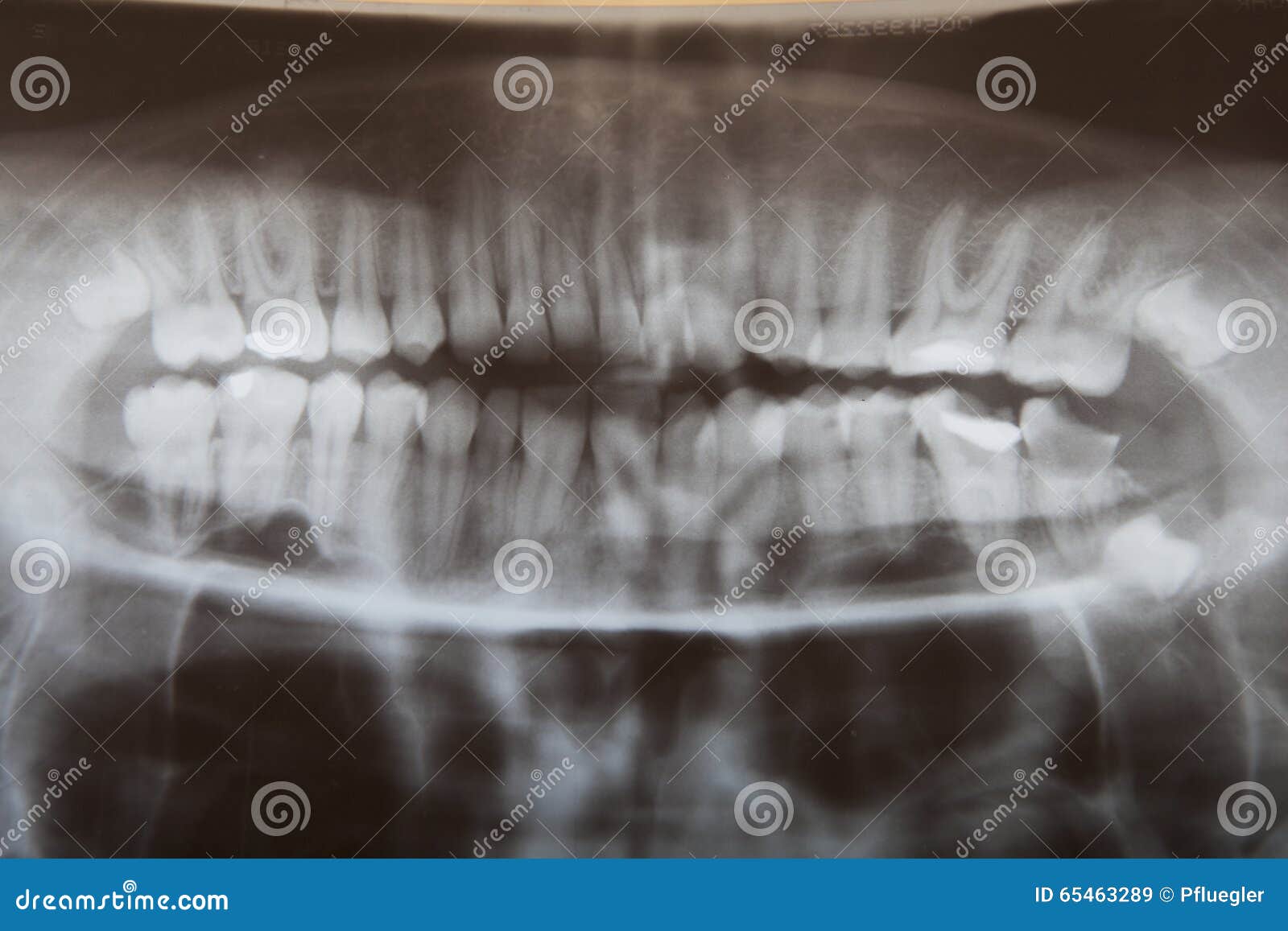 Radiograph teeth stock image. Image of tooth, bone, radiation - 65463289