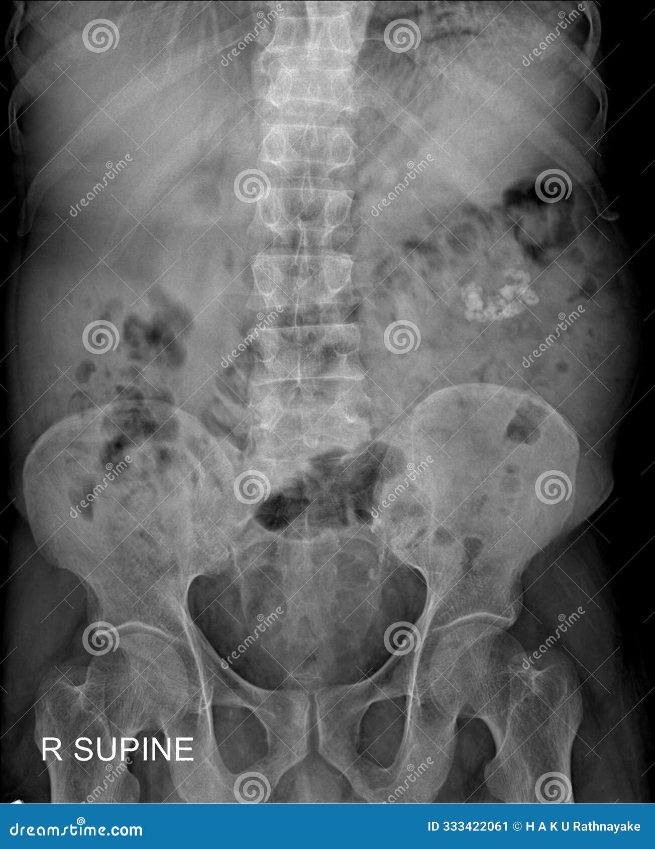 Radiographic Image of a KUB (kidneys, Ureters, Bladder) Stock Image ...
