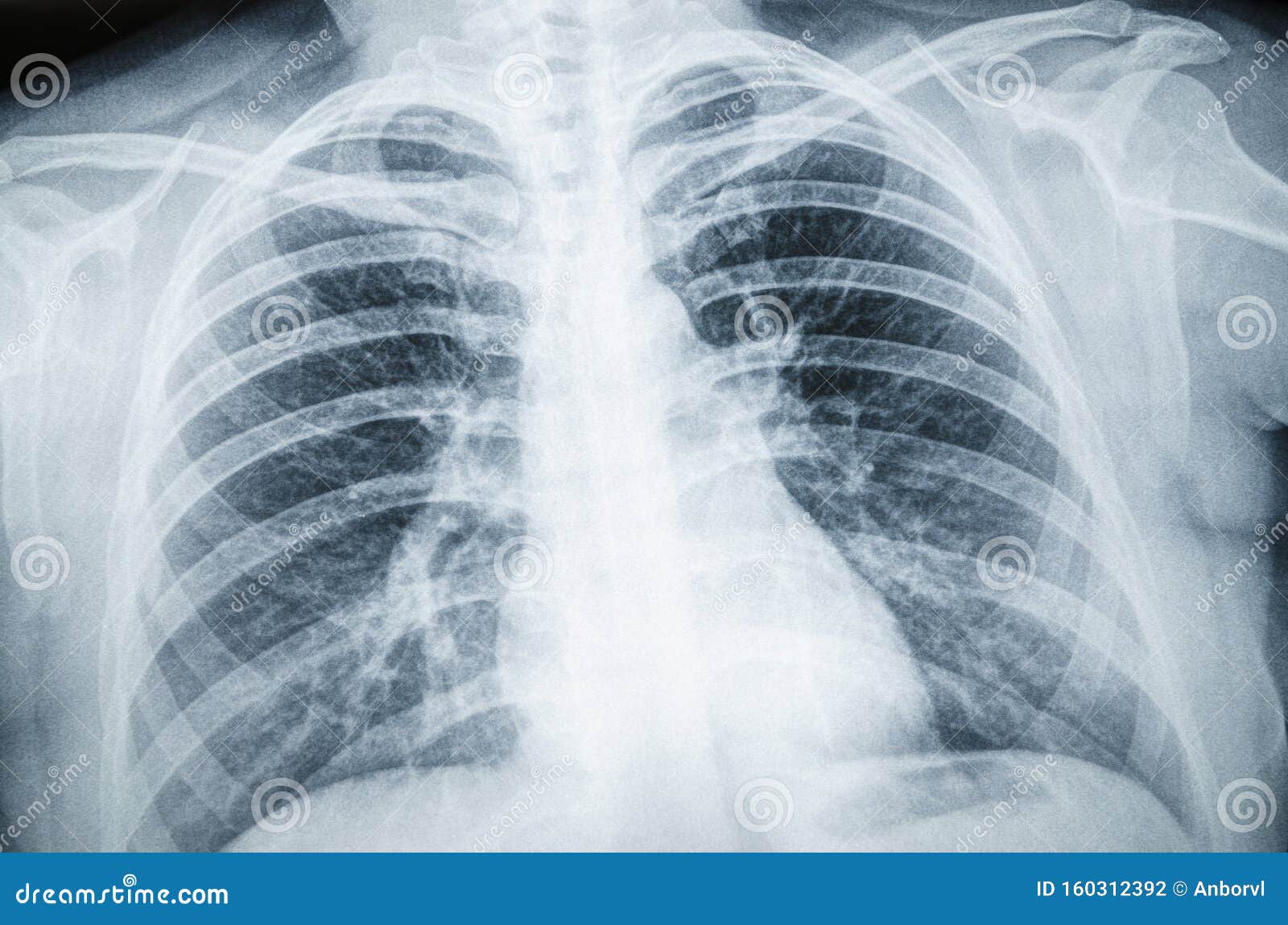 Radiographic Image of the Respiratory Tract, Lungs Stock Photo - Image ...
