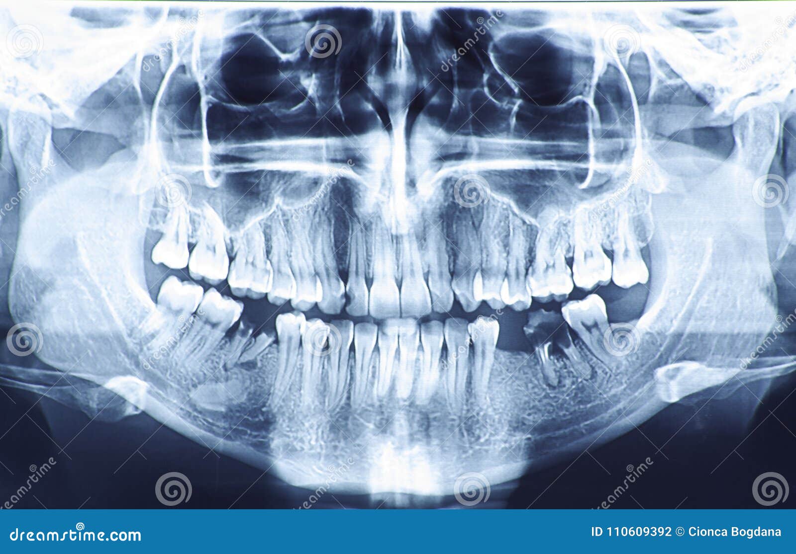Radiographie Dentaire Panoramique De Haute Résolution Photo stock ...