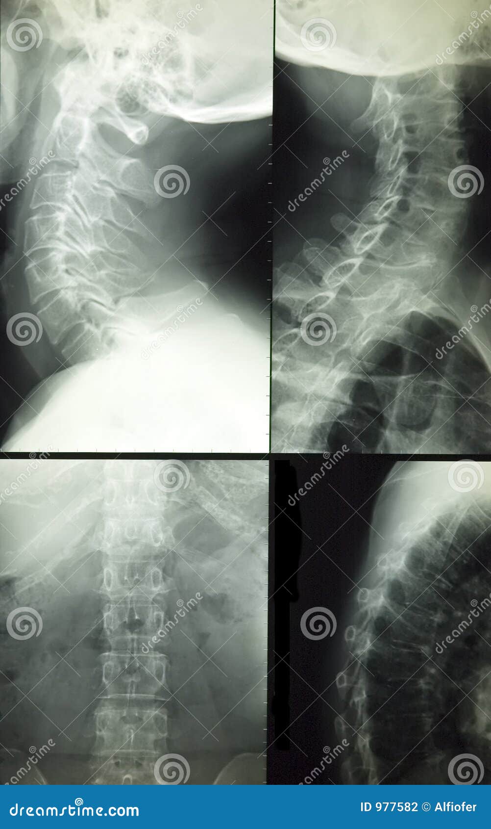 Radiographie du rayon X photo stock. Image du mort, médecine - 977582