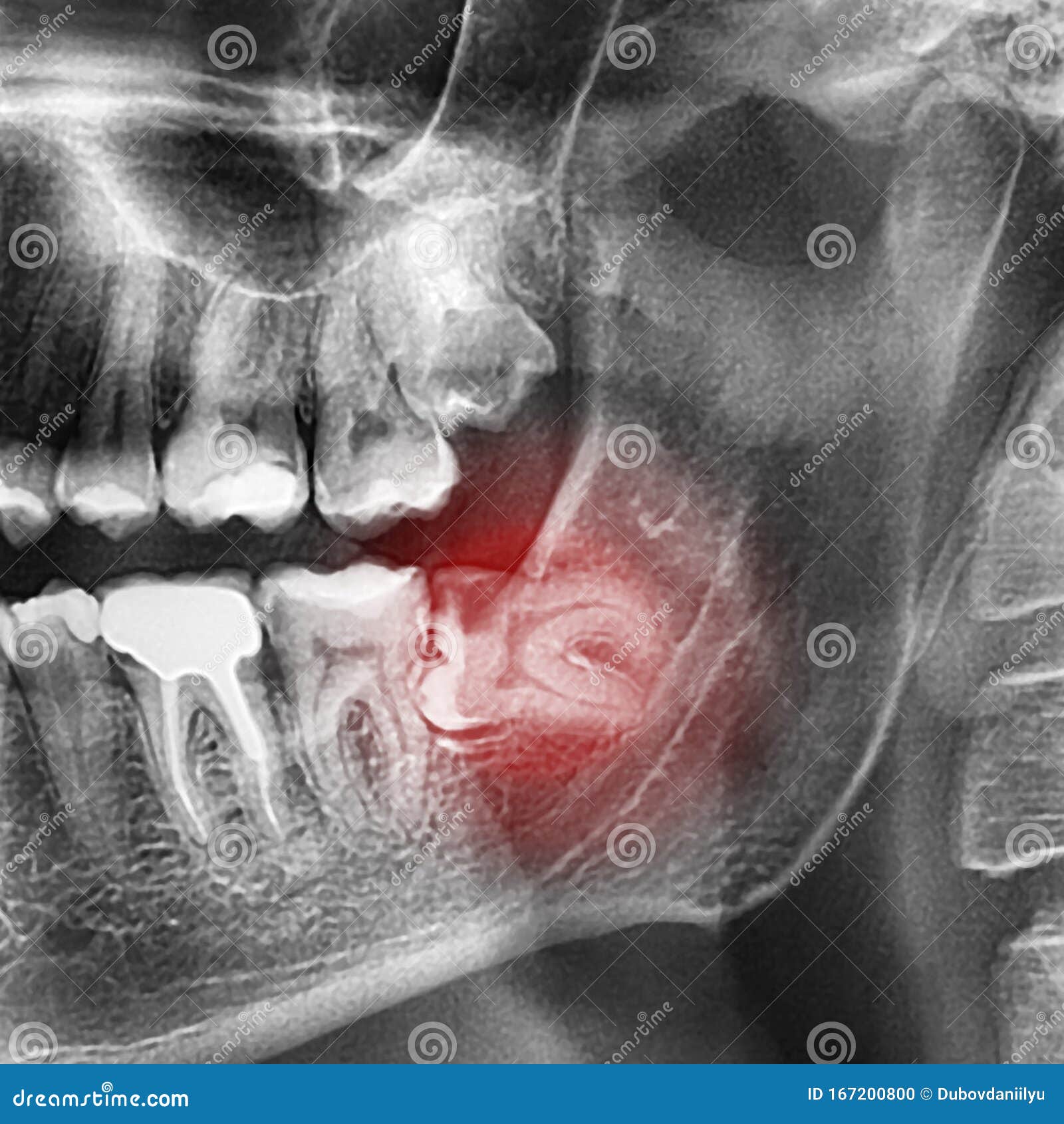 Radiographs of the teeth stock photo. Image of care - 167200800