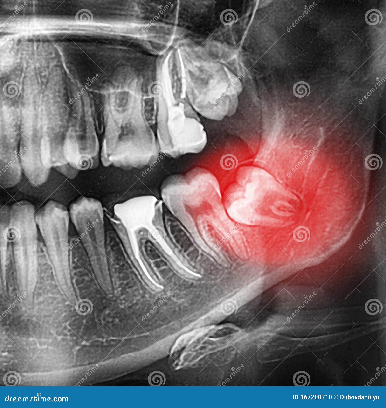 Radiographs of the teeth stock photo. Image of oral - 167200710