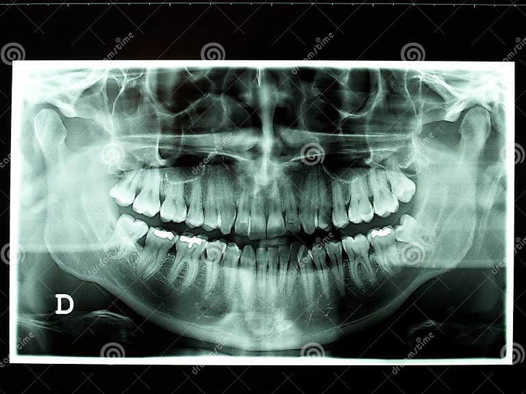 Radiography stock image. Image of hospital, black, radiography - 2306999