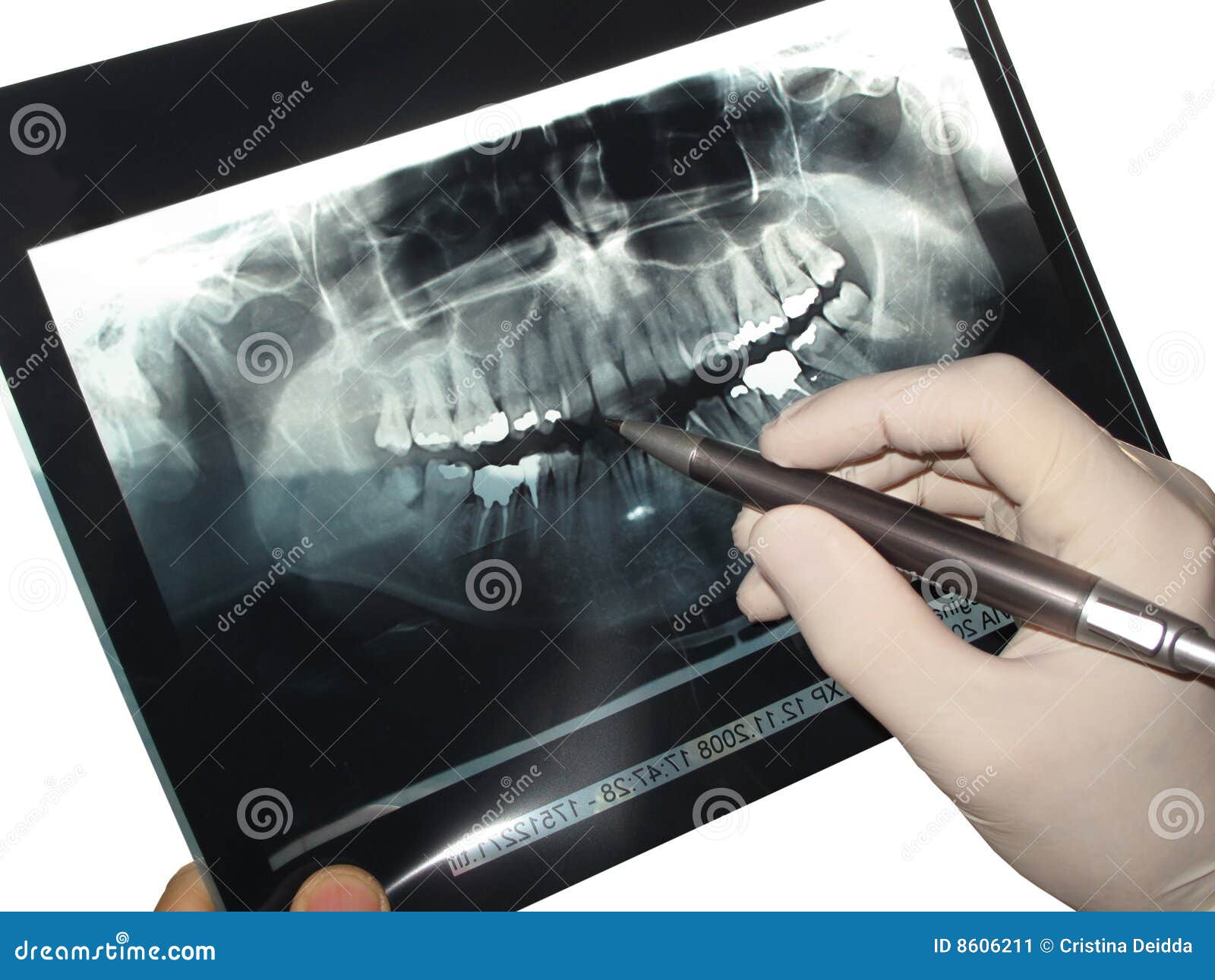 Radiography stock image. Image of digestion, oral, molars - 8606211