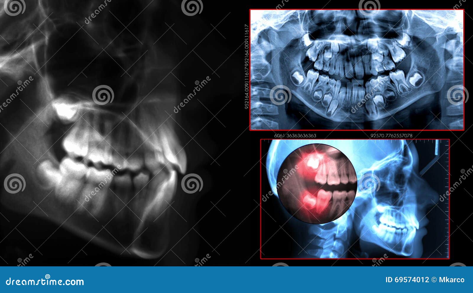 Radiography dental scan stock photo. Image of dentist - 69574012