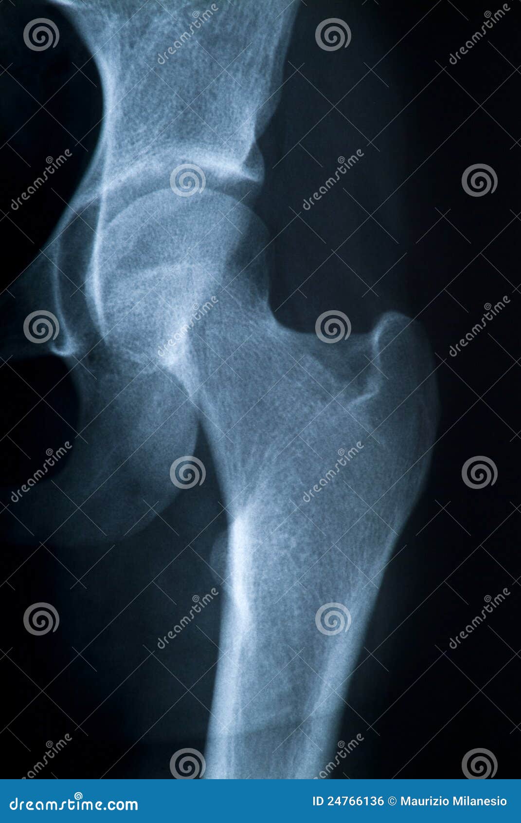 Radiography of the femur stock photo. Image of light - 24766136