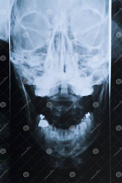 Radiography of the Head and Teeth Stock Photo - Image of data ...