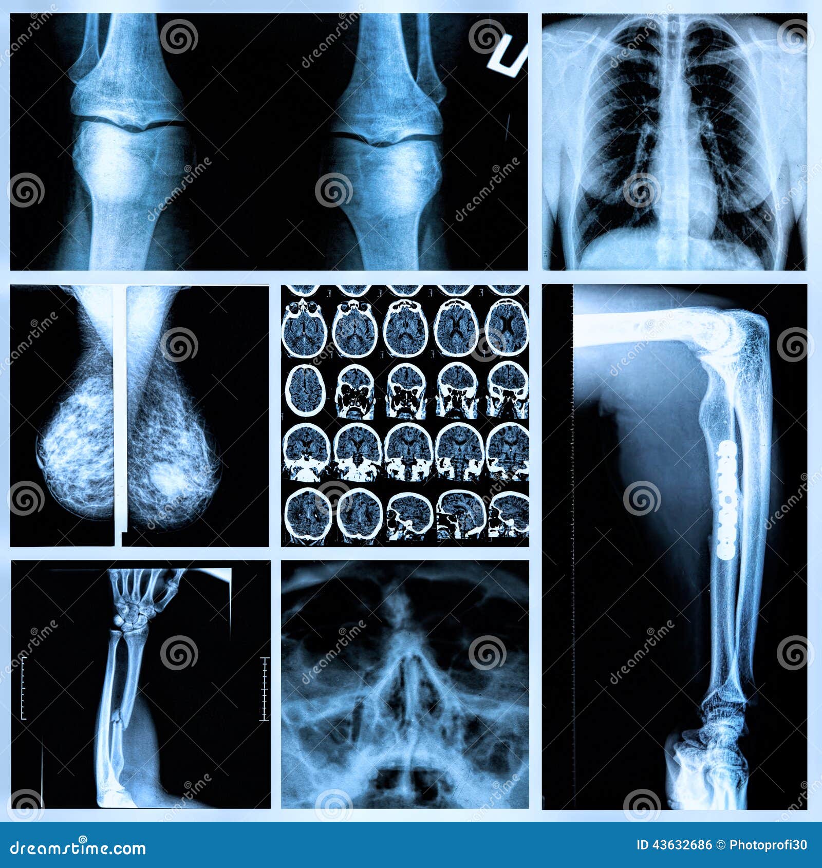 Radiography of Human Bones stock photo. Image of bones - 43632686