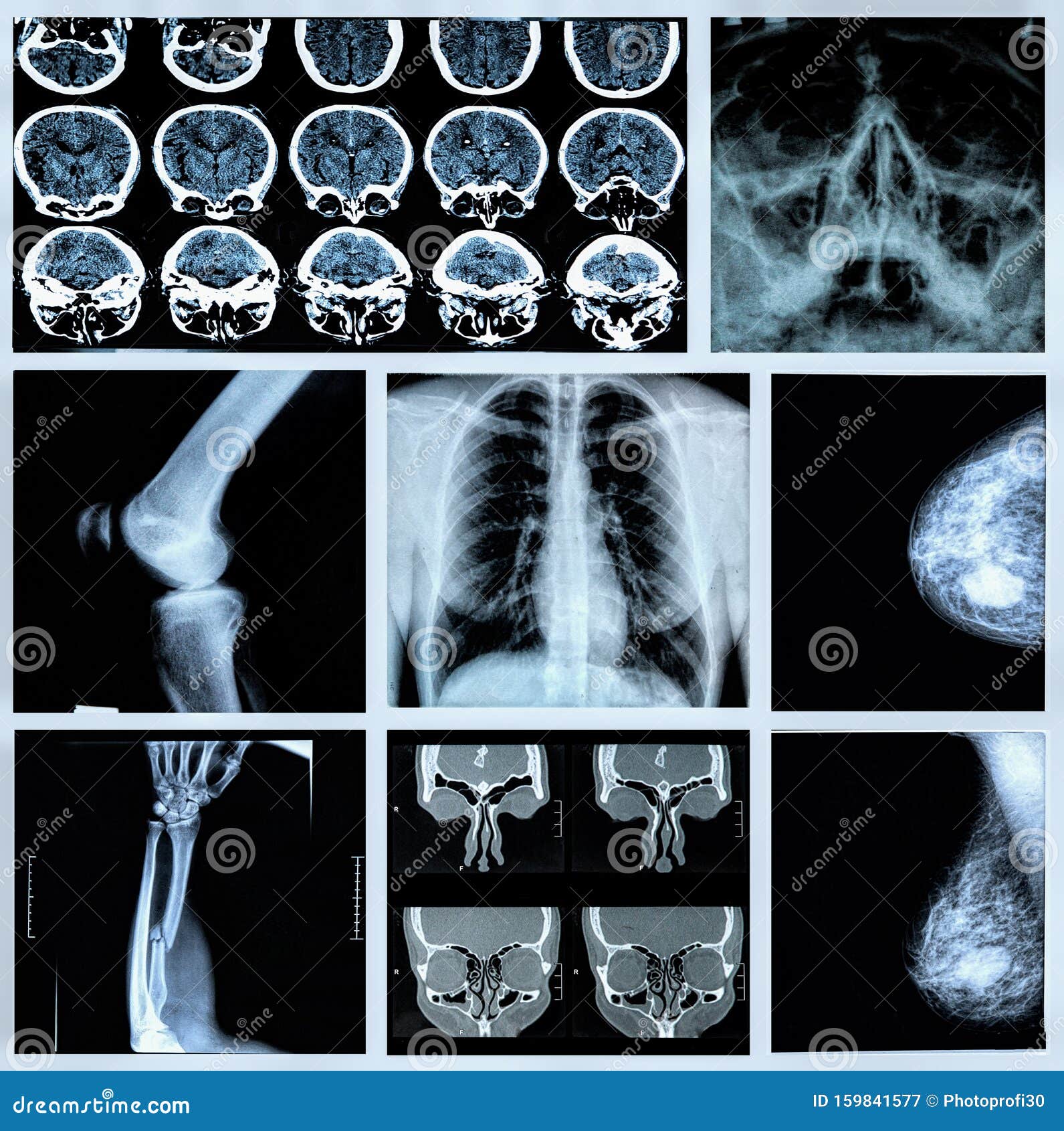 Radiography of Human Bones stock image. Image of chest - 159841577
