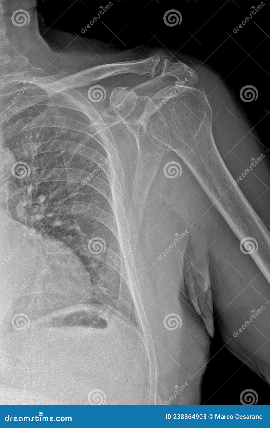 Radiography of the Shoulder Joint Stock Image - Image of bones, bone ...