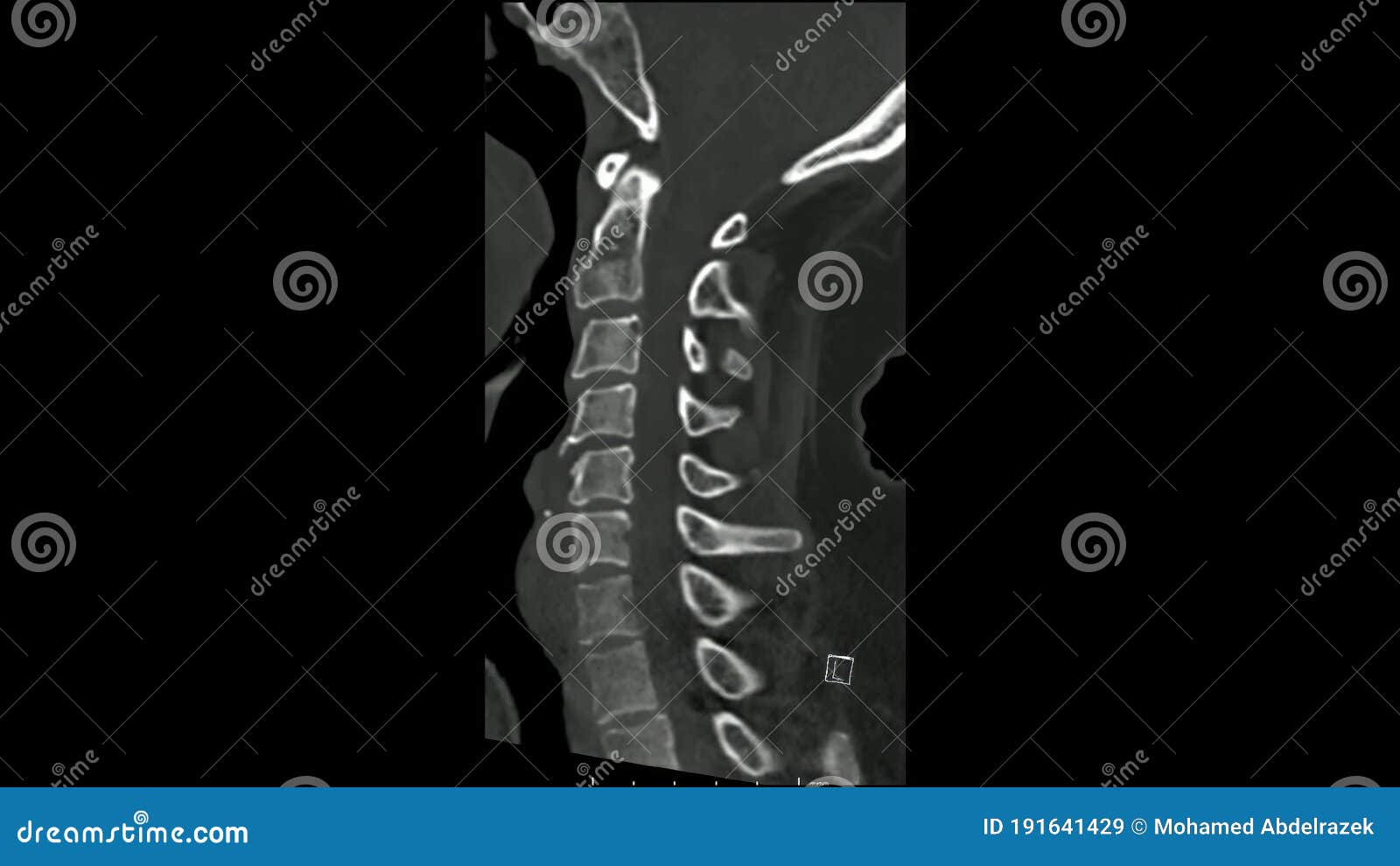 Computed Tomography Examination of the Cervical Spine CT CS Sagittal in ...