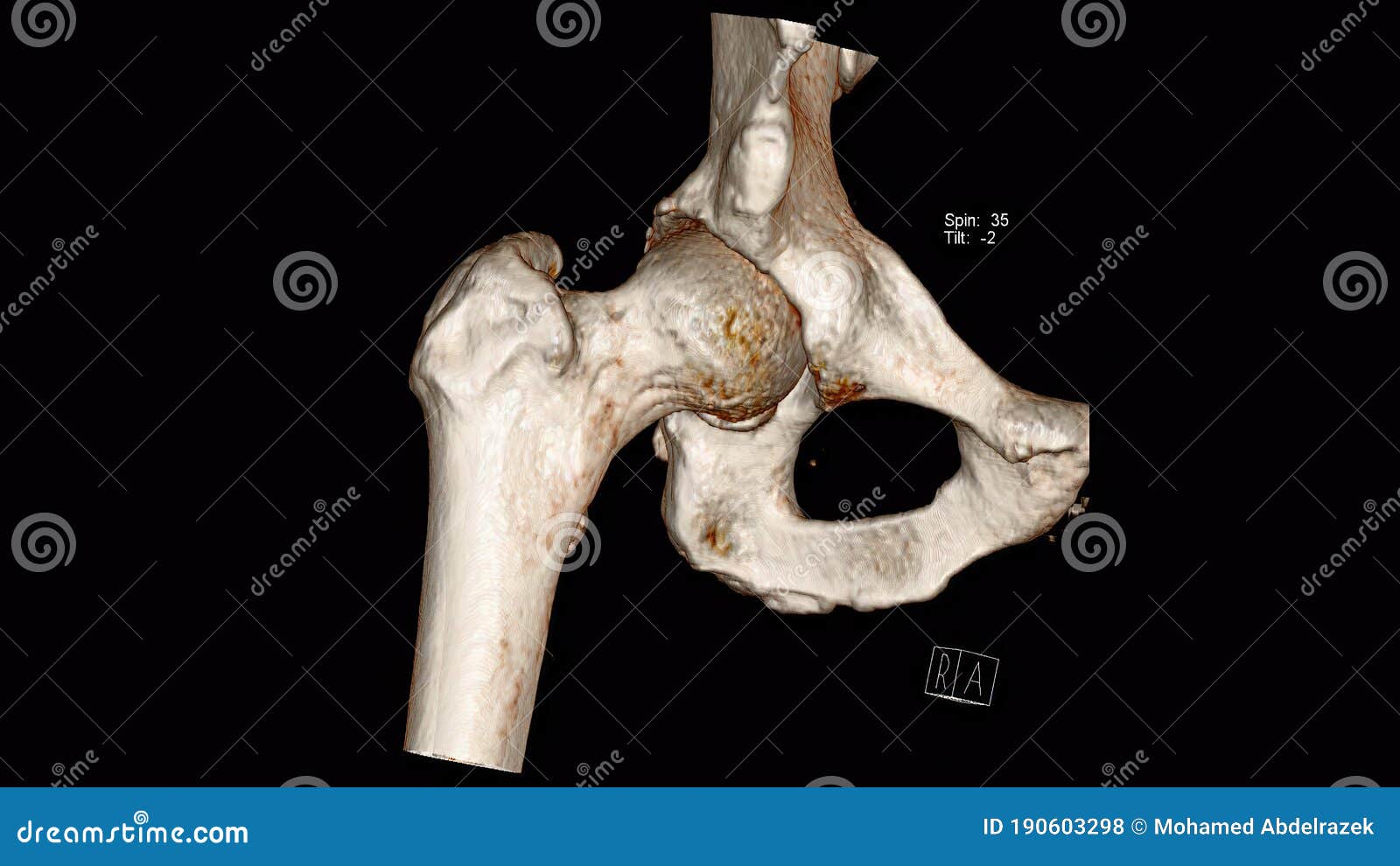 Computed Tomography Volume Rendering Examination of the Hip Joint CT VR ...