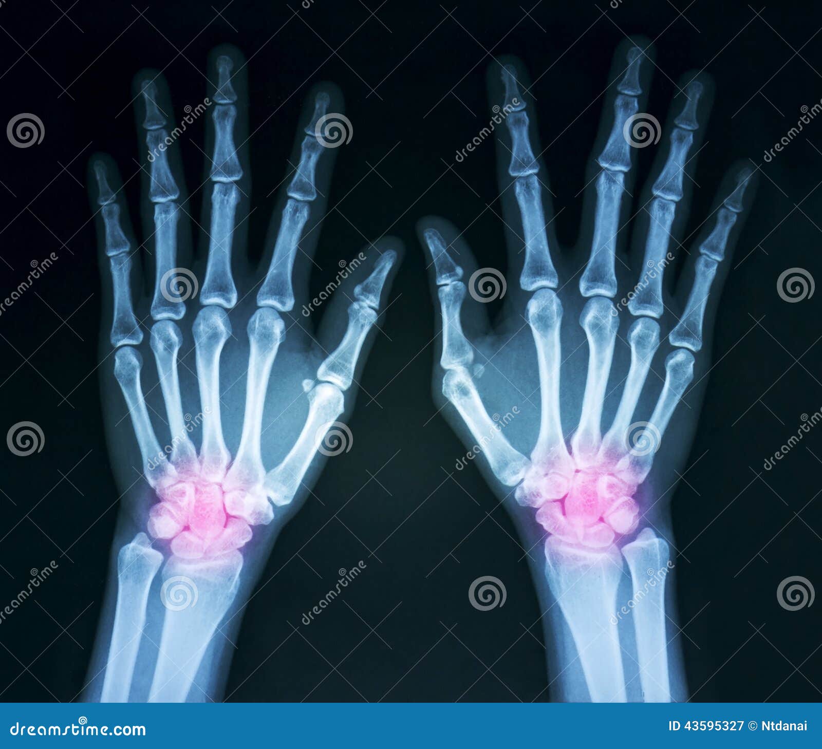 Raggi x del film immagine stock. Immagine di ferita, diagnosi - 43595327