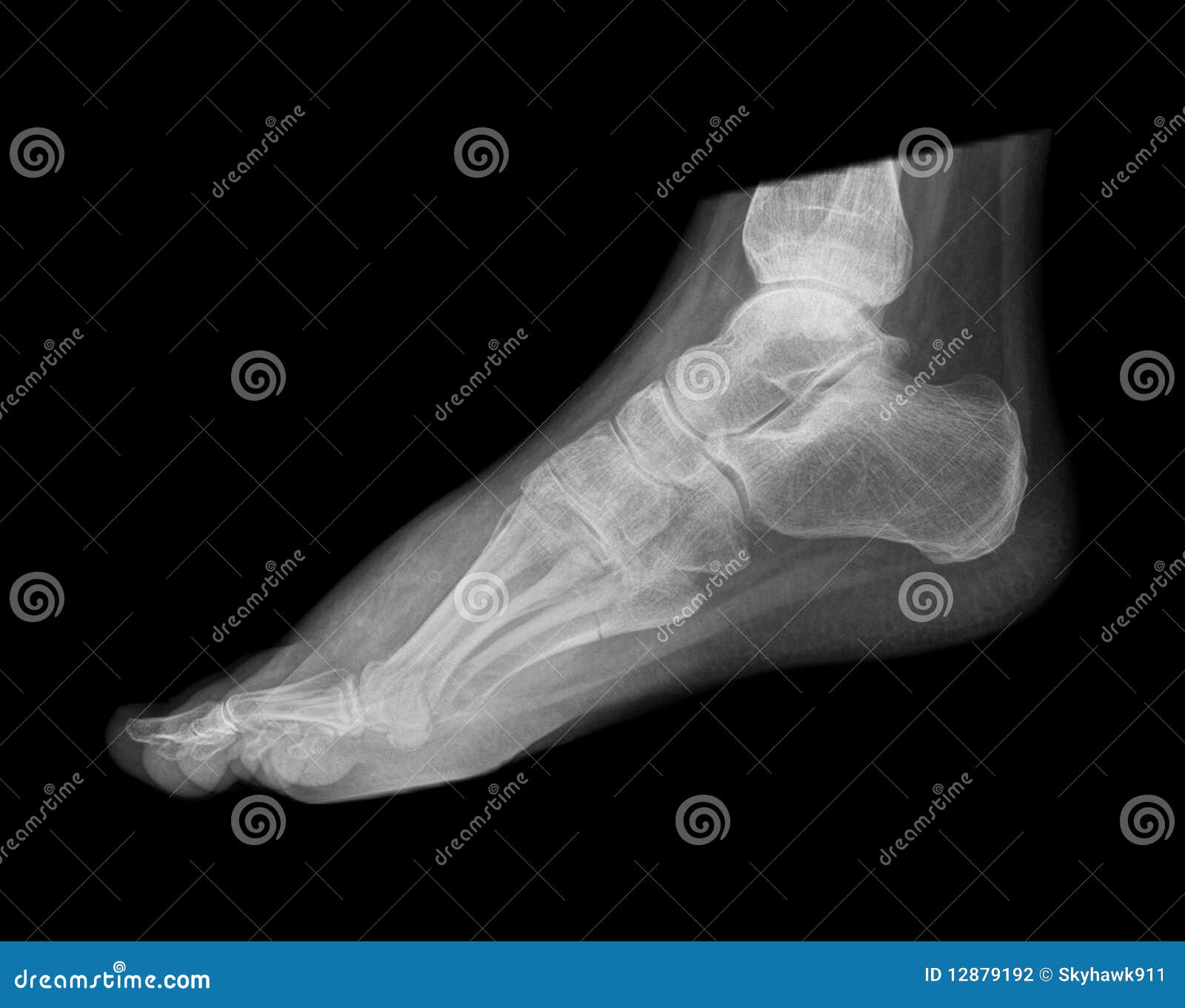 Raggi X del piede fotografia stock. Immagine di radiazione - 12879192