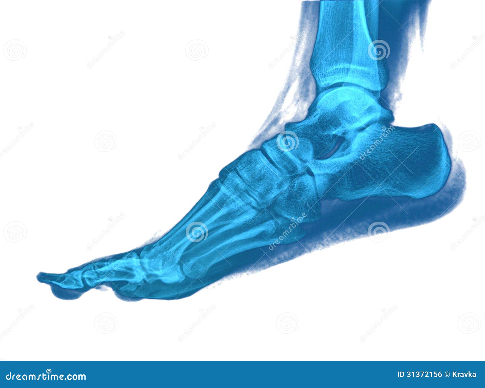 Raggi x del piede fotografia stock. Immagine di radiologia - 31372156