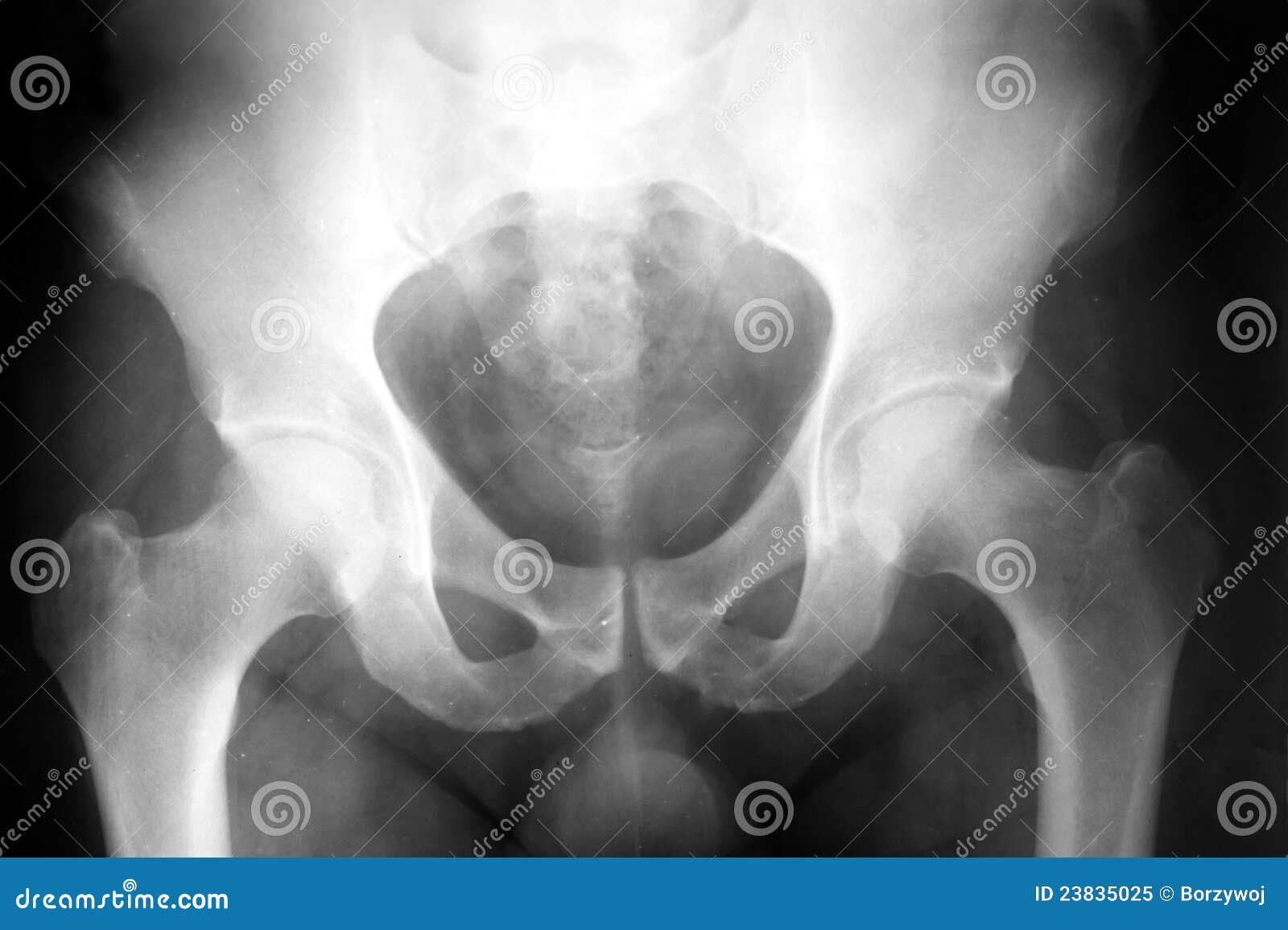 Raggi X dell'anca immagine stock. Immagine di radio, malattia - 23835025